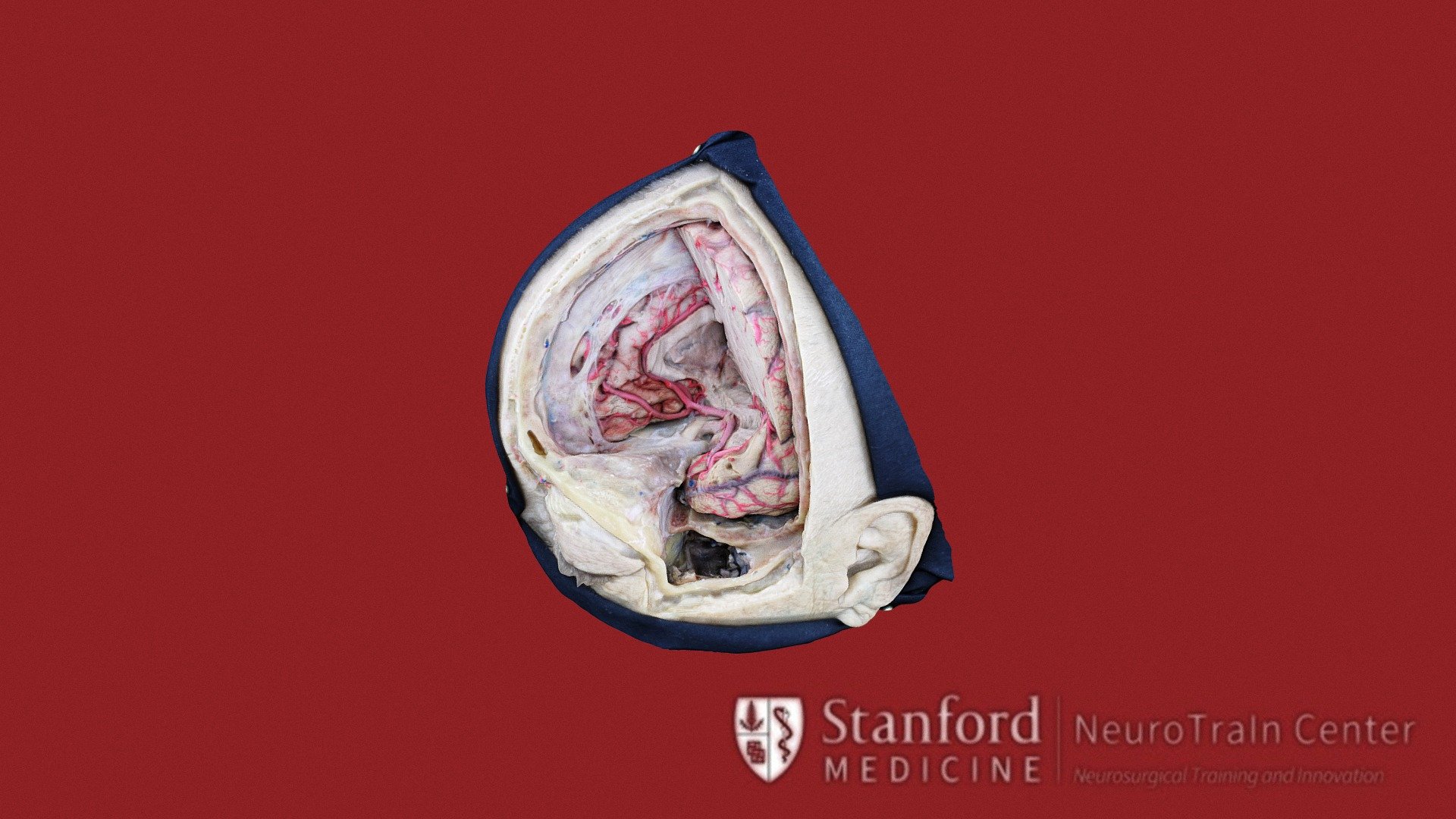 Craniotomy - step 2 - 3D model by vv (@verav) [d4cc9b5] - Sketchfab