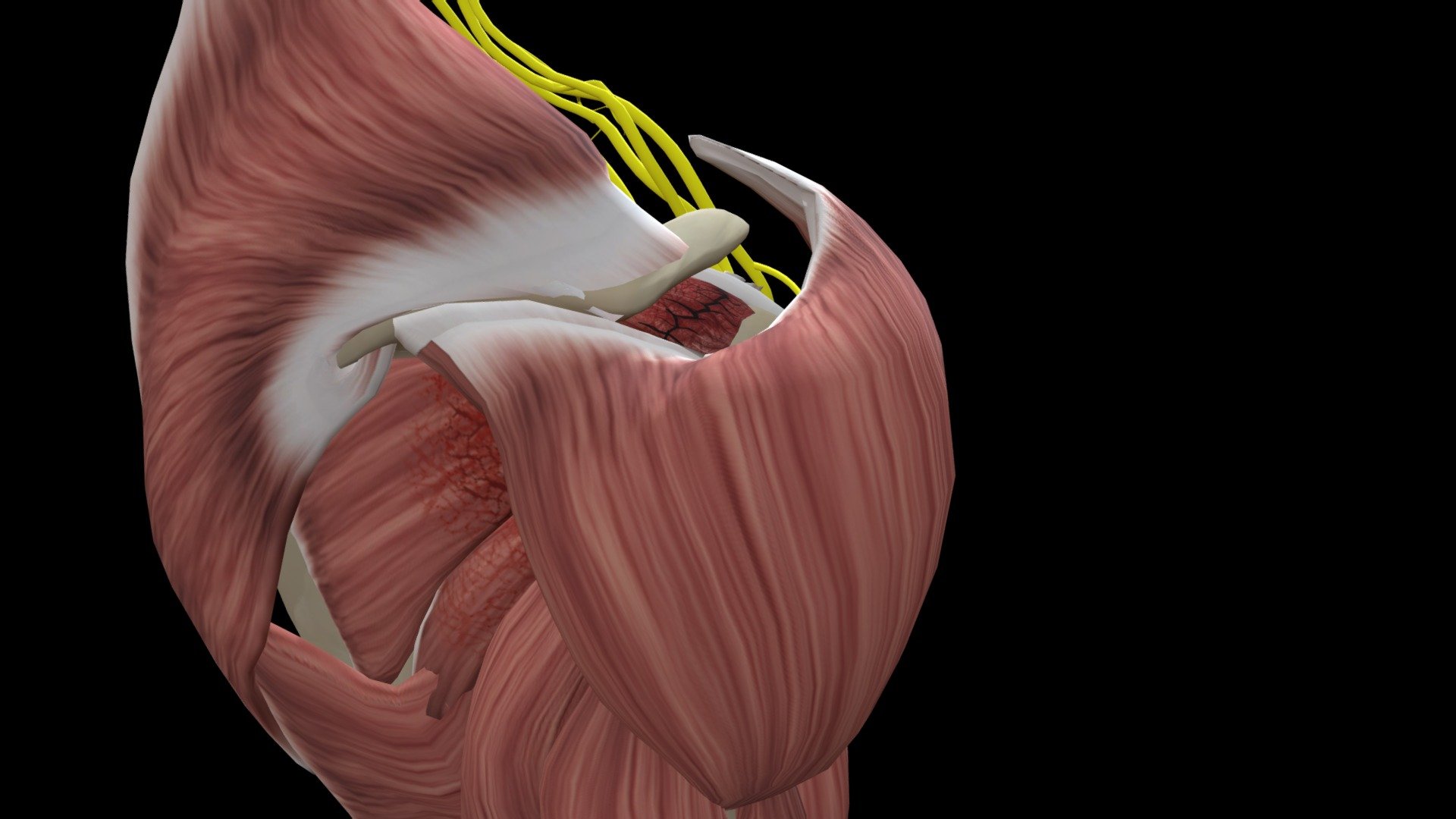 Supraspinatus Rupture & Inflamed Rotator Cuff - 3D model by Connections ...