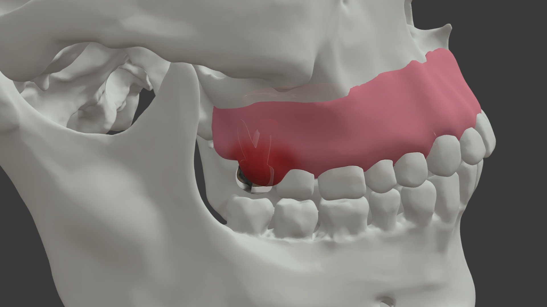 Stage 5 Short Root Maxillary Dental Infection - 3D model by University ...