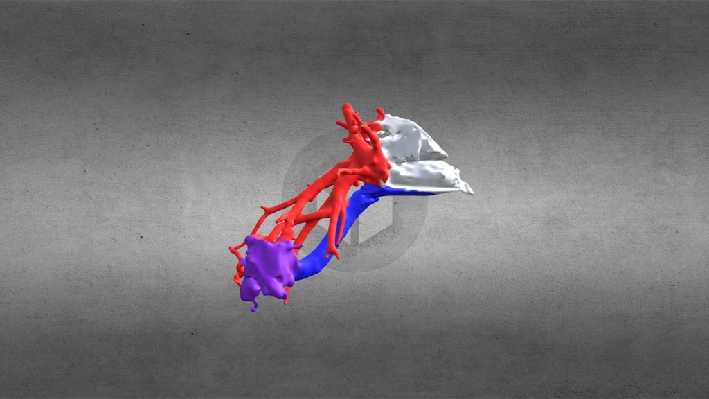 Pulmonary AVM - 3D model by jonbra [d562f1d] - Sketchfab