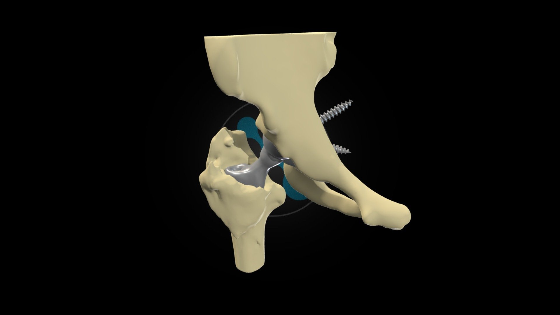 HumanX Hip-TEP (f) right - 3D model by HumanX Medical Simulators ...