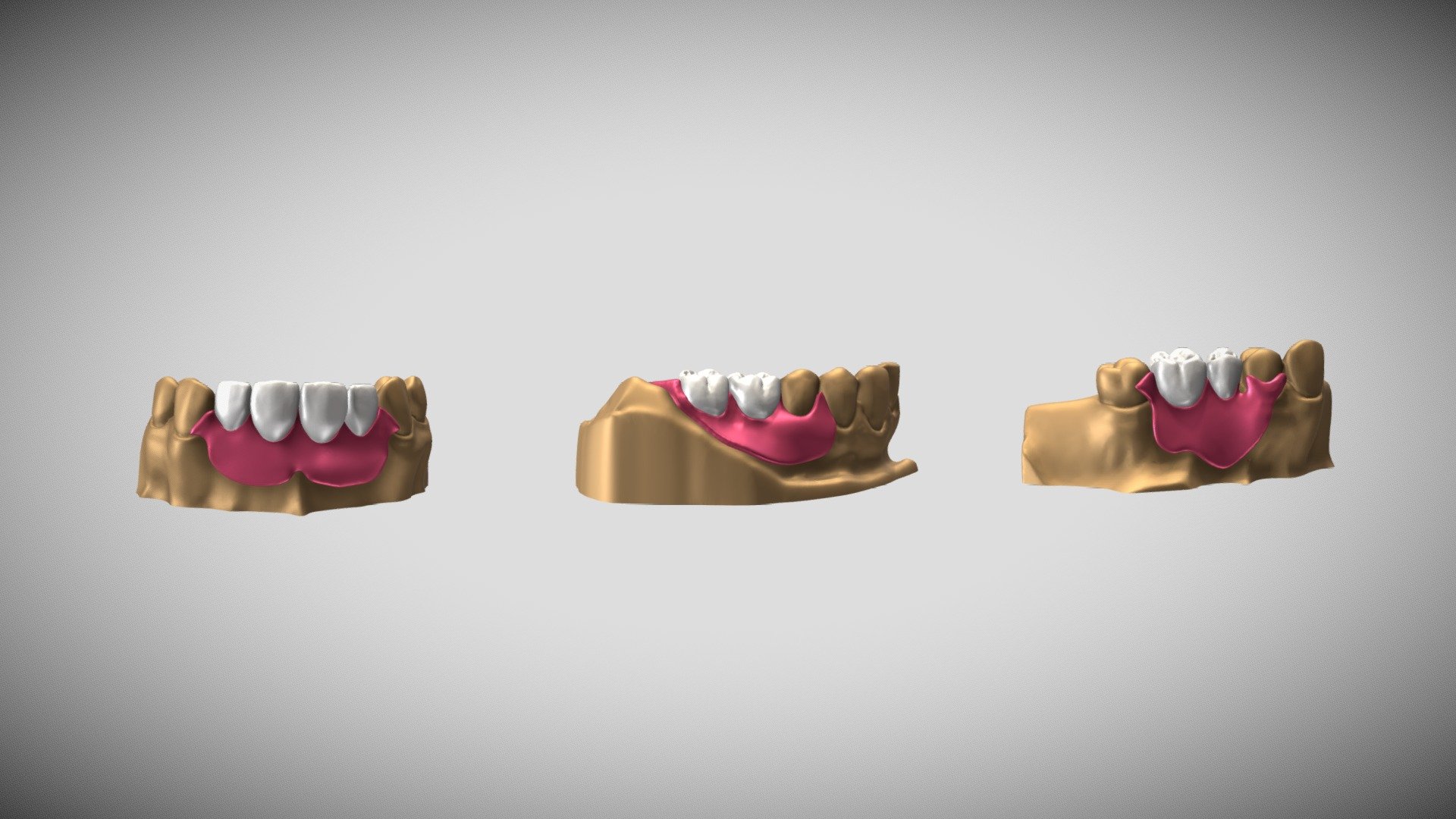 Flexible Denture Clasps Part 1 - 3D model by Muhammad Nabeel ...