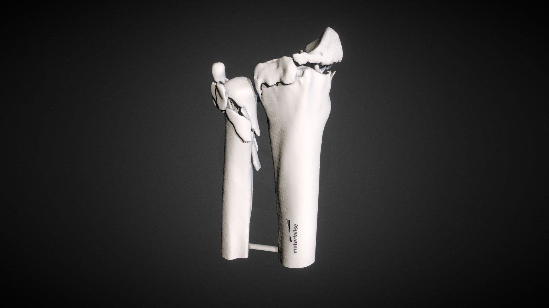 DKOU18 | distal Radius fracture | L-172414-L - 3D model by World ...