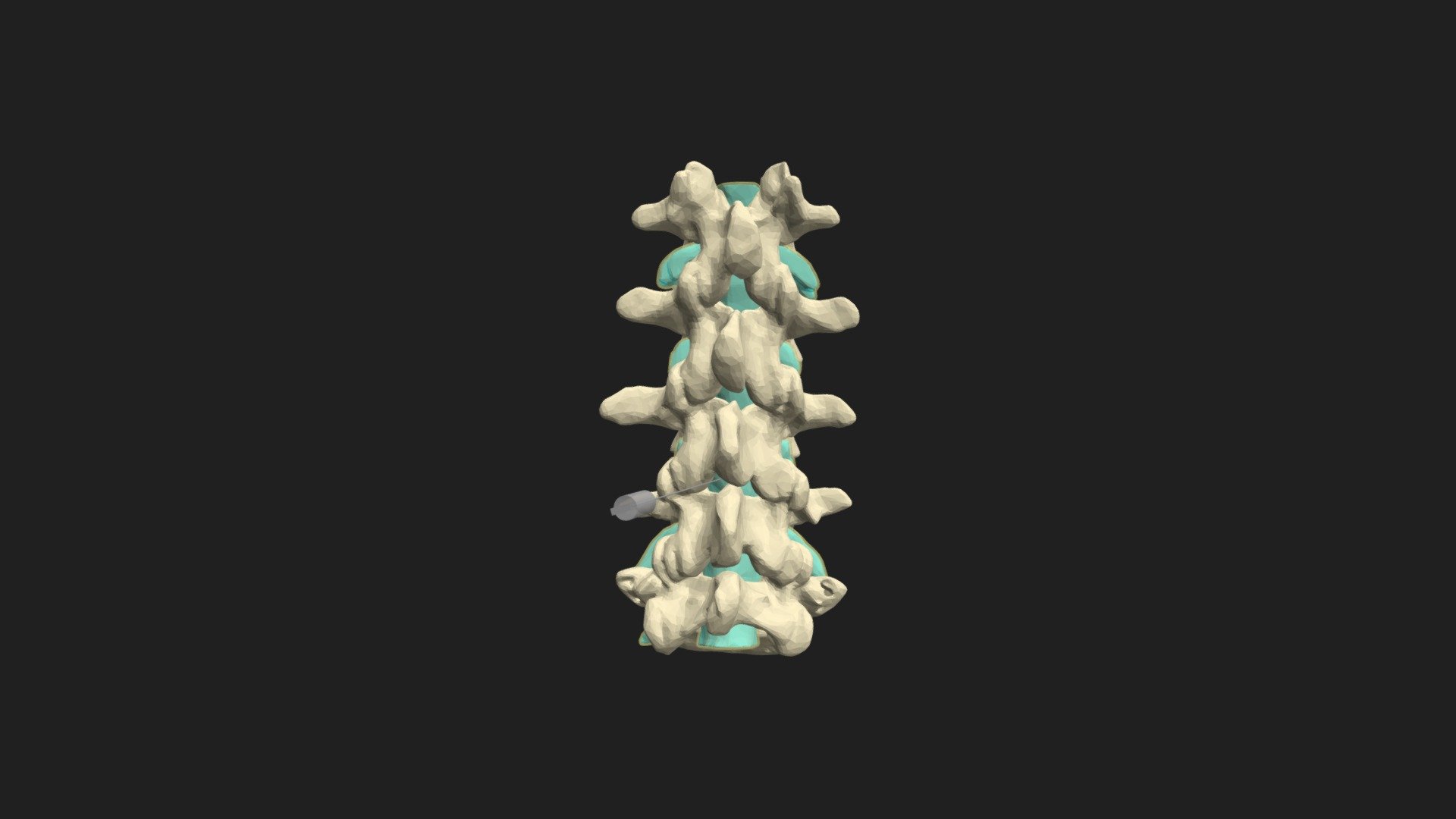 Lumbar Puncture - 3D model by Justin Cramer (@jcramer) [d5eb4bc ...
