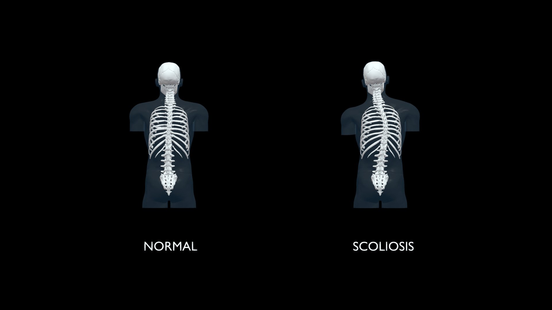 Scoliosis Comparision with Normal Human Spine - Buy Royalty Free 3D ...