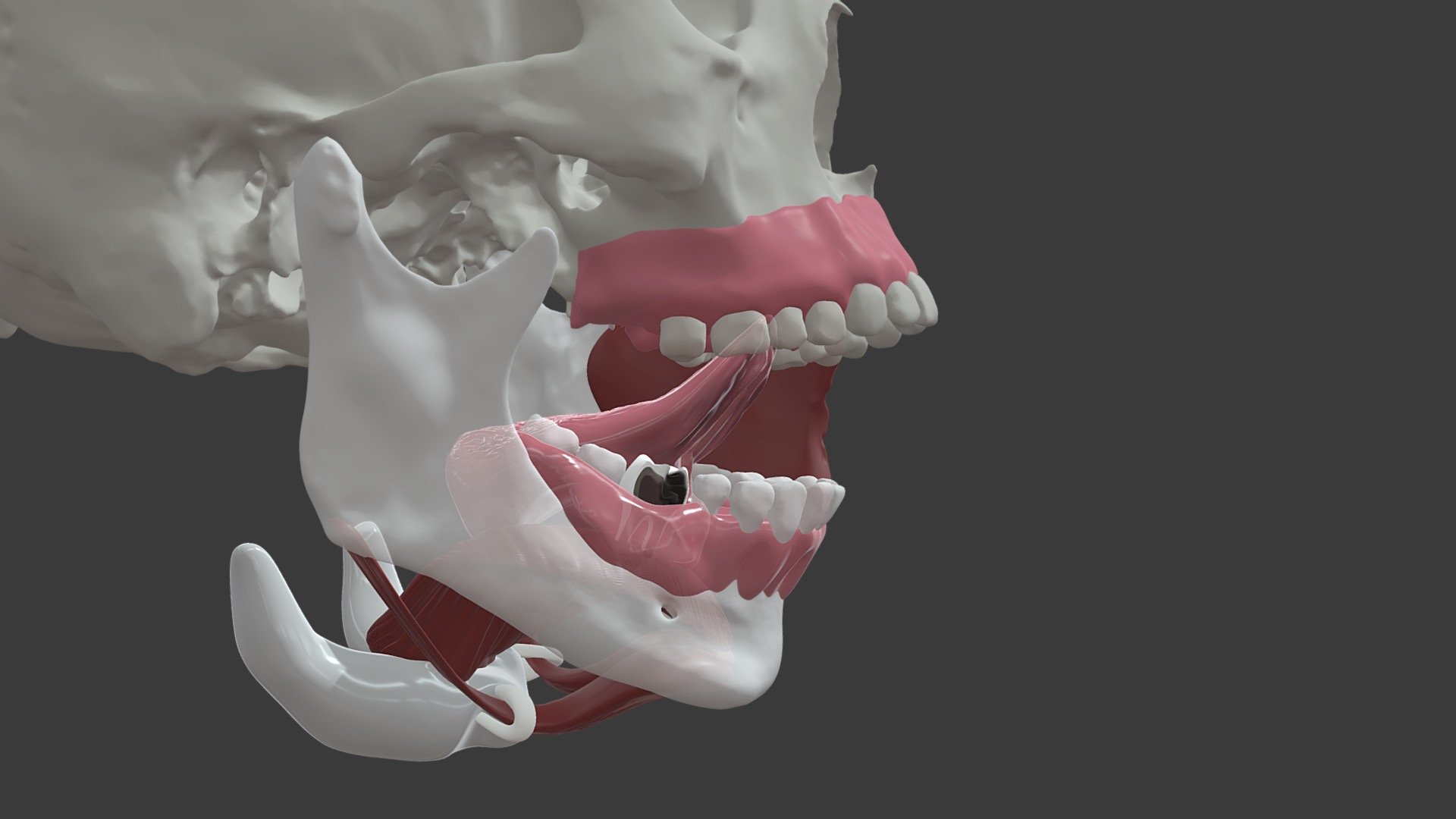 Stage 3 - Mandibular Molar Infection Pathway 4 - 3D model by University ...
