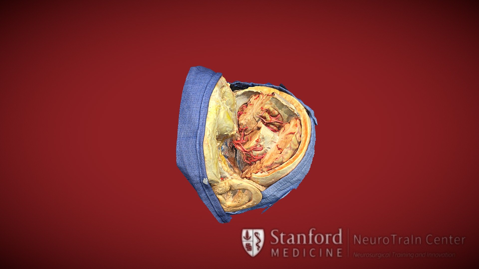 Anterior and Middle Fossa Dissection - 3D model by vv (@verav) [d6f0cea ...