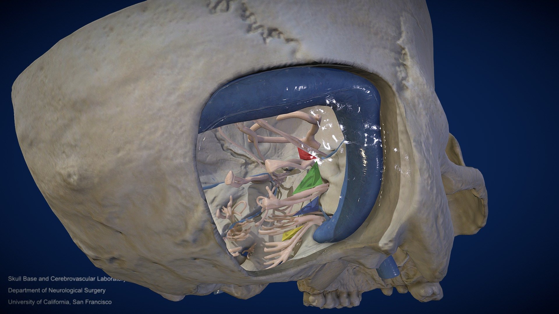 Model 8: RS Craniotomies & Intradural Triangles - Download Free 3D ...