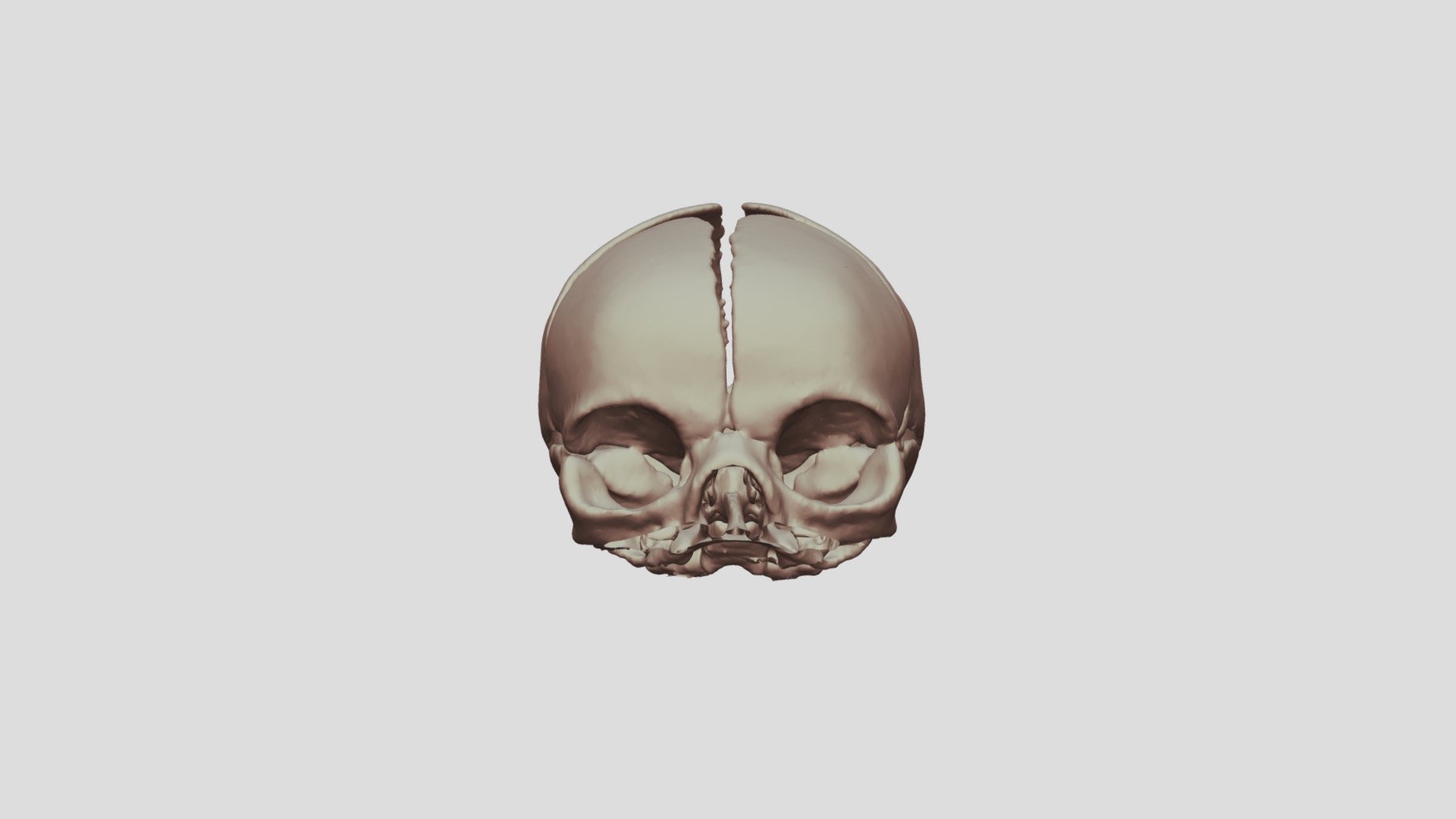 Ping Pong fracture - 3D model by nascene [d728fb9] - Sketchfab