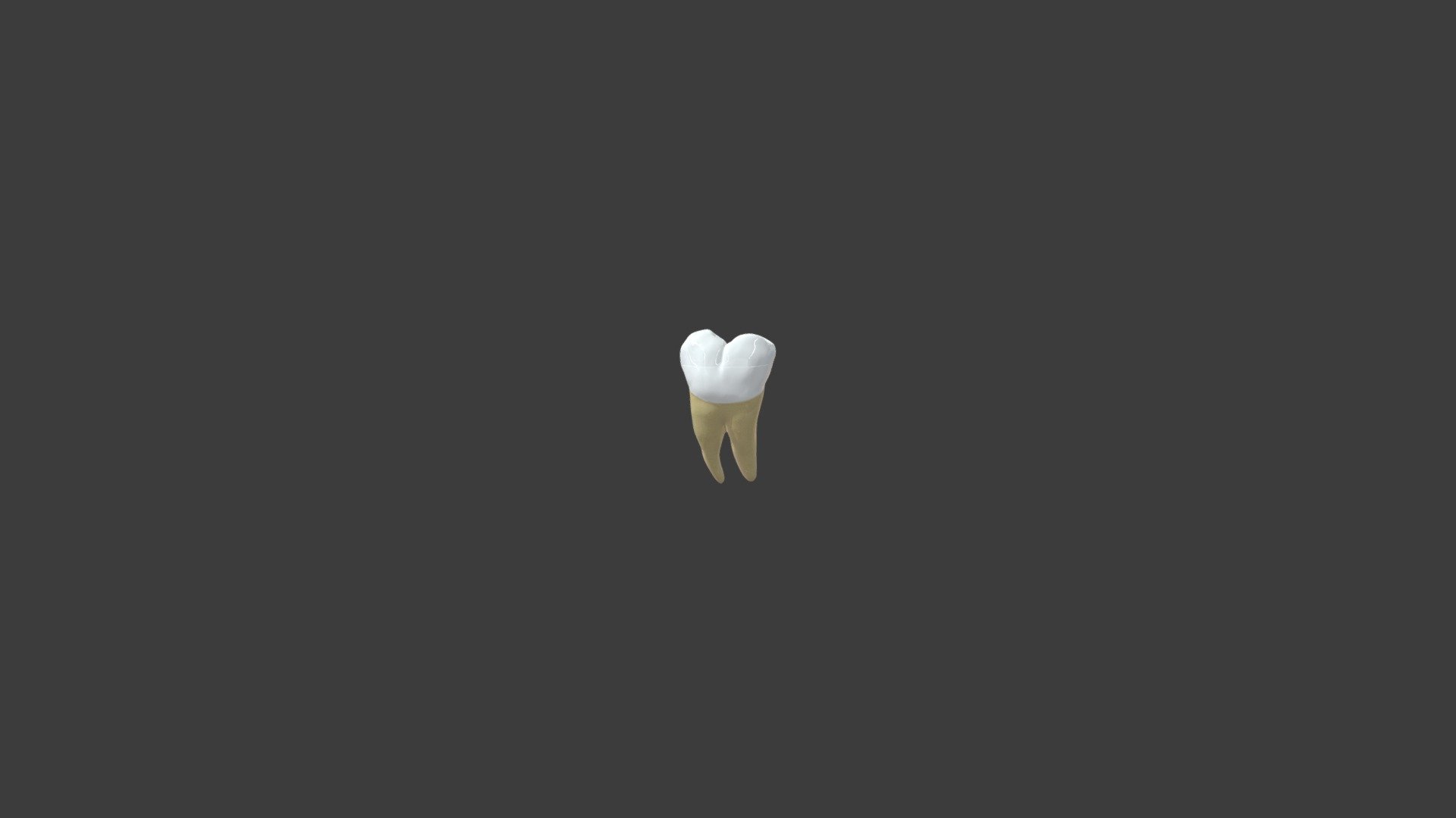 ceramic Onlay Prep tradiitional - 3D model by Ahmed Mahrous ...