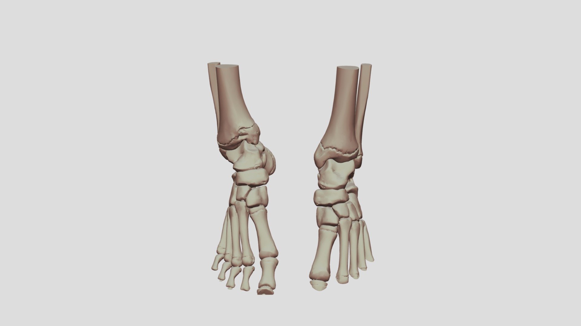 Untreated Fracture (S0272) - 3D model by NCHS Cardiac Advanced Projects ...