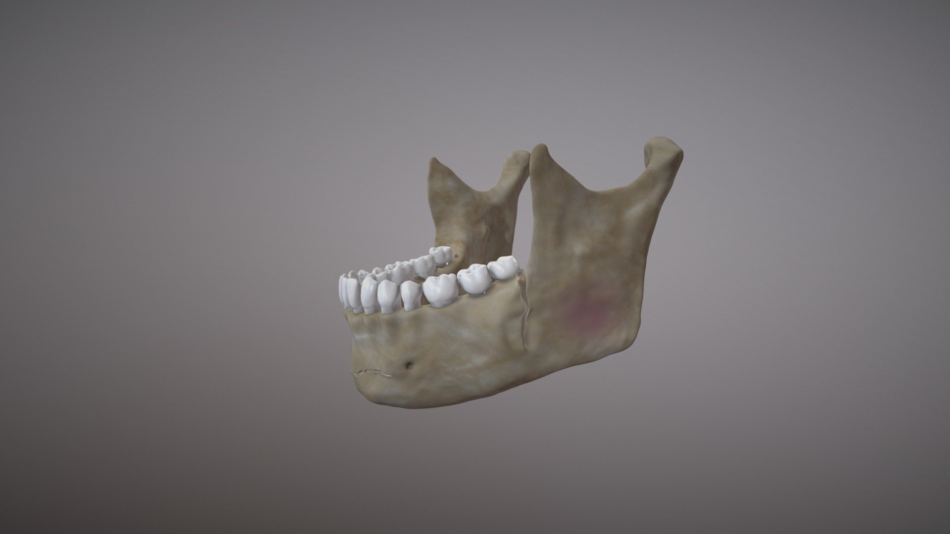 Fracture Classification- Incomplete - 3D model by University of Dundee ...