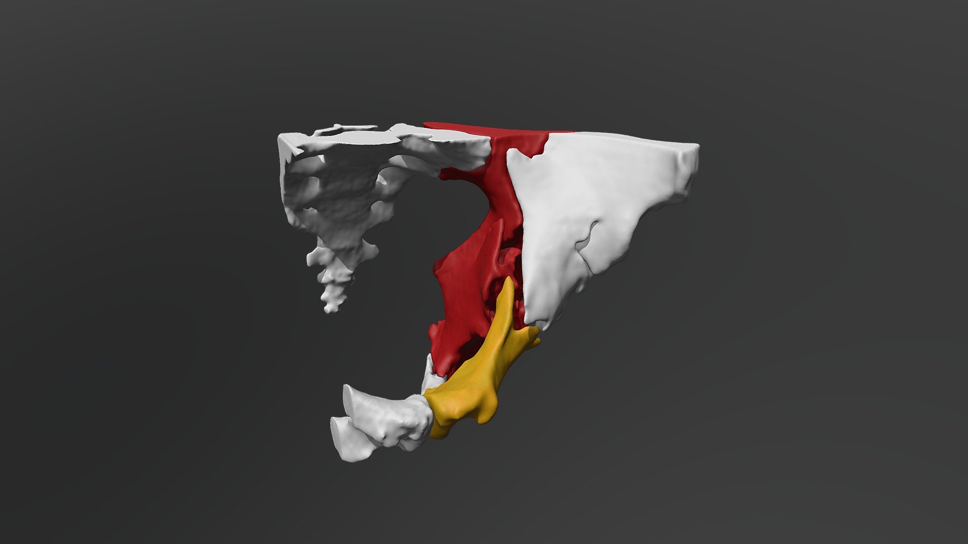 Acetabular fracture - both columns - 3D model by valchanov [d85e3b6 ...