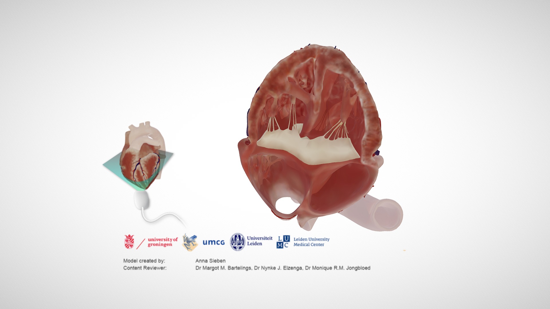 Atrioventricular septal defect, 4 chamber view - Download Free 3D model ...