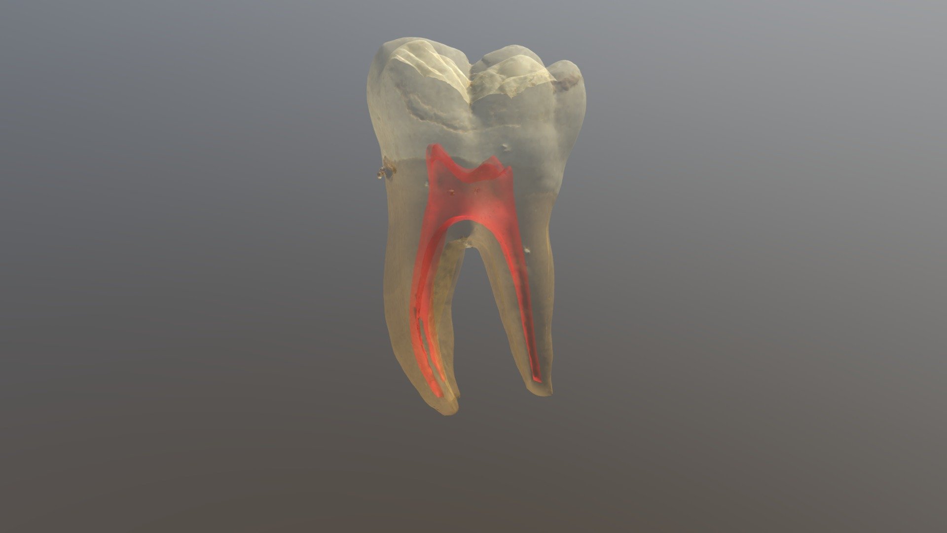 Mandibular Left First Molar - 3D model by Alexander Jon Cresswell-Boyes ...