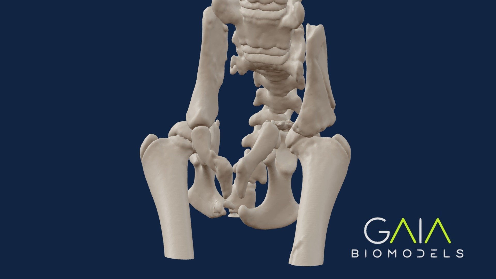 Pelvis Fracture Cat 3 Months 3d Model By Gaia Biomodels