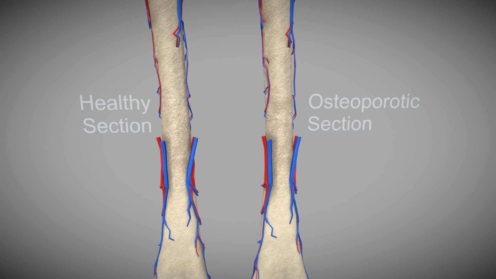 Healthy And Osteoporotic Bones - 3D model by 3D4SCI [d9a05a9] - Sketchfab