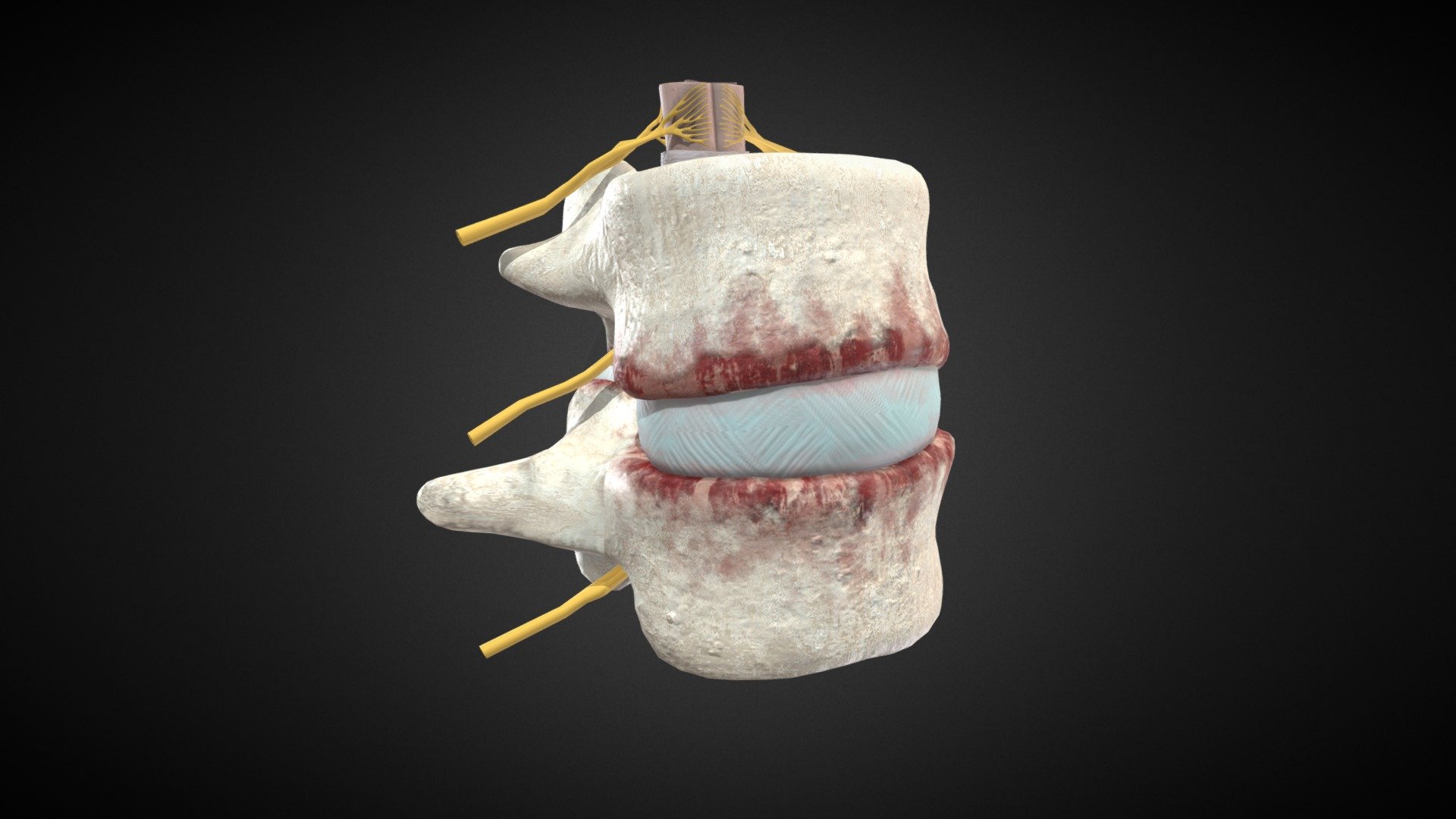 Inflammation - 3D model by imiridley [d9ff11a] - Sketchfab