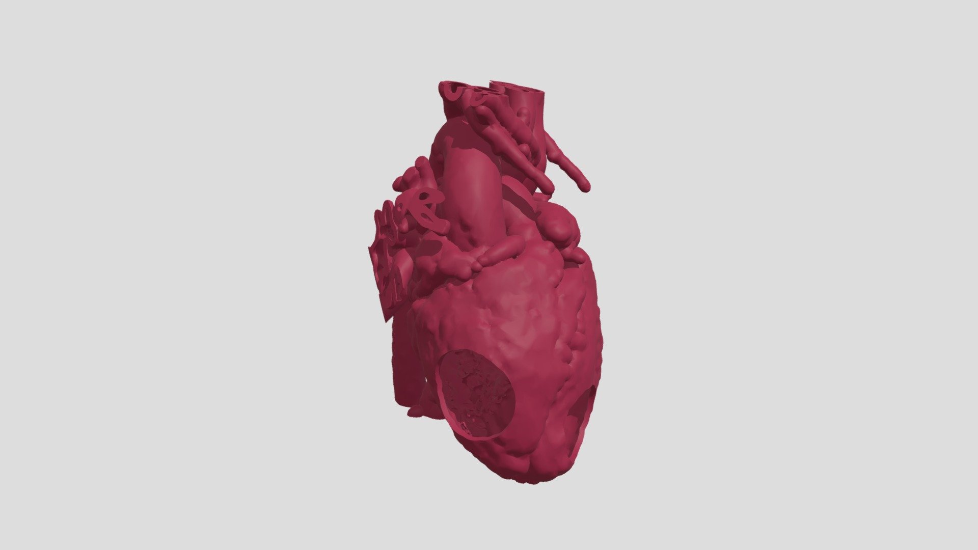 DORV with VSD, Balanced CAVC, TAPVR (H0319) - 3D model by NCHS Cardiac ...