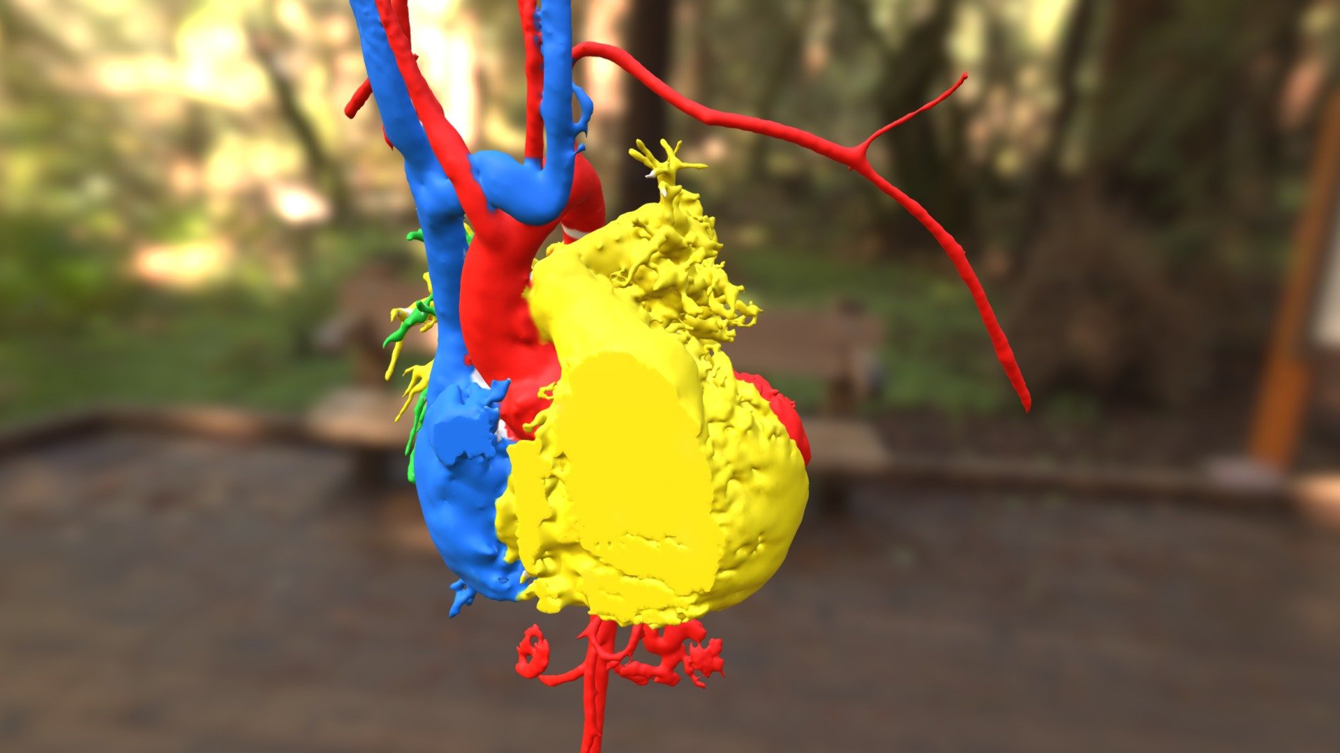 IVP - VD AD dilat - Download Free 3D model by quequen [da4e930] - Sketchfab