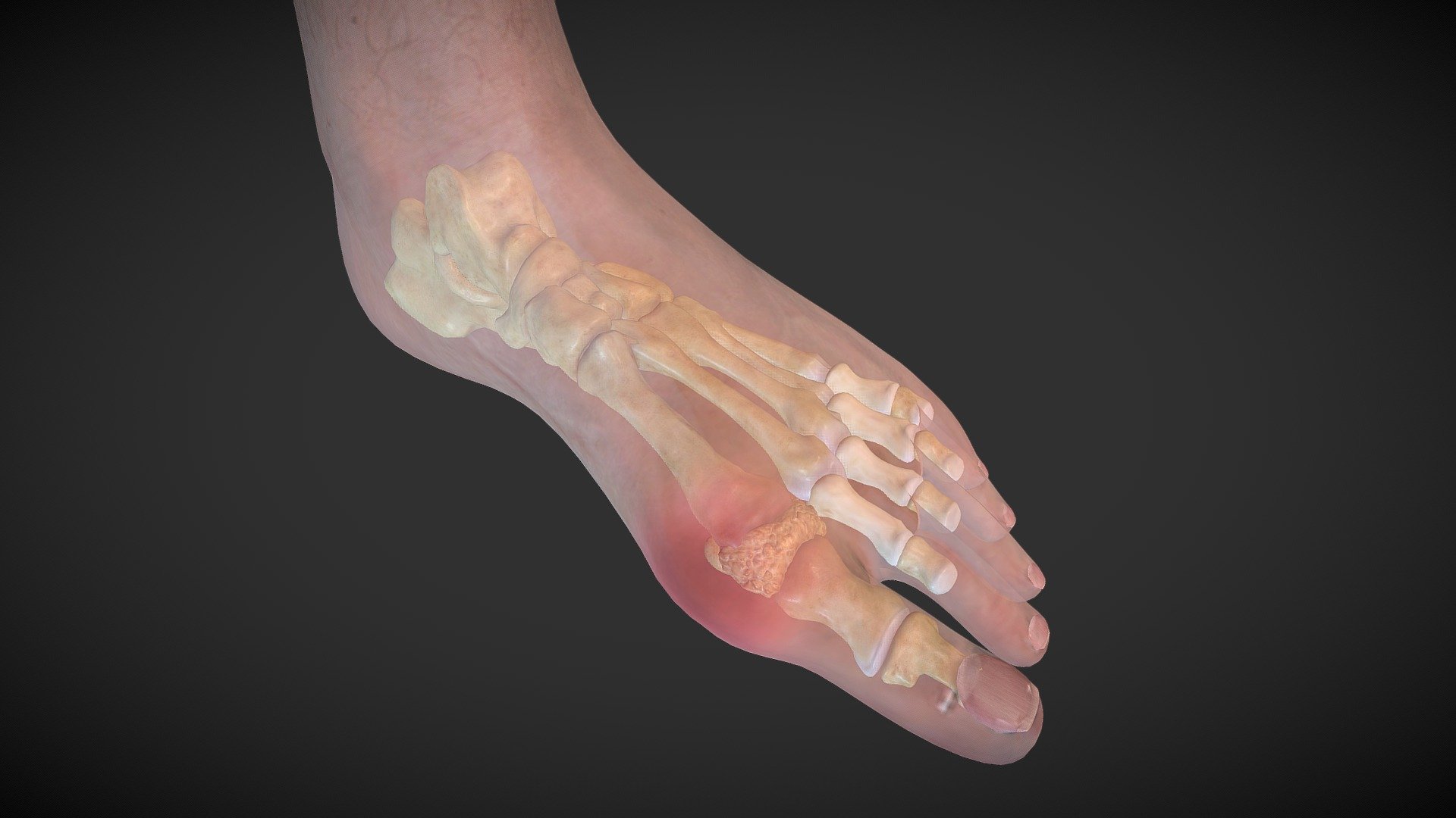 Gout - Buy Royalty Free 3D model by Ebers [db09c20] - Sketchfab Store