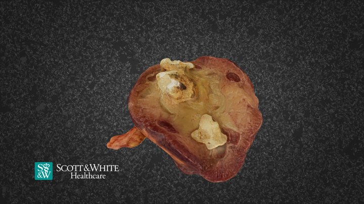 Ureteritis 3D models - Sketchfab