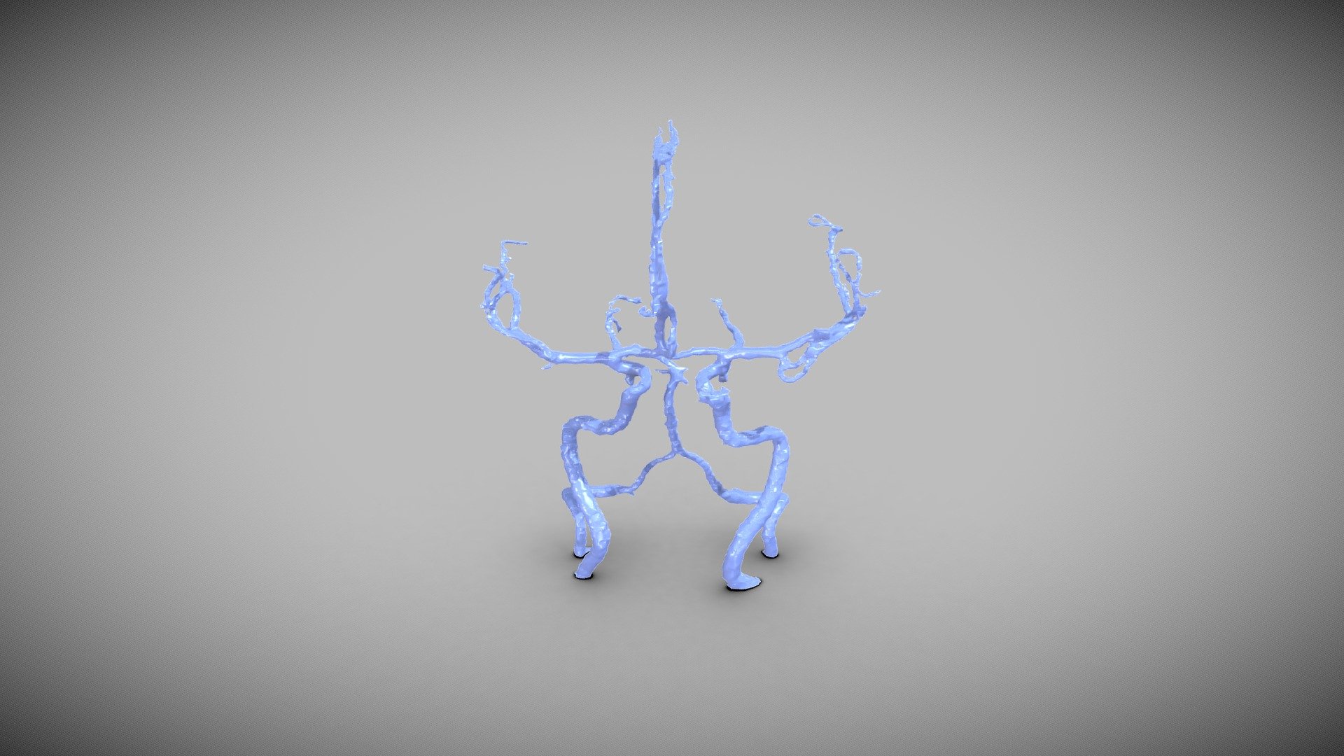 TS - PComm Aneurysm - Buy Royalty Free 3D model by Dr. Samuel Damin ...