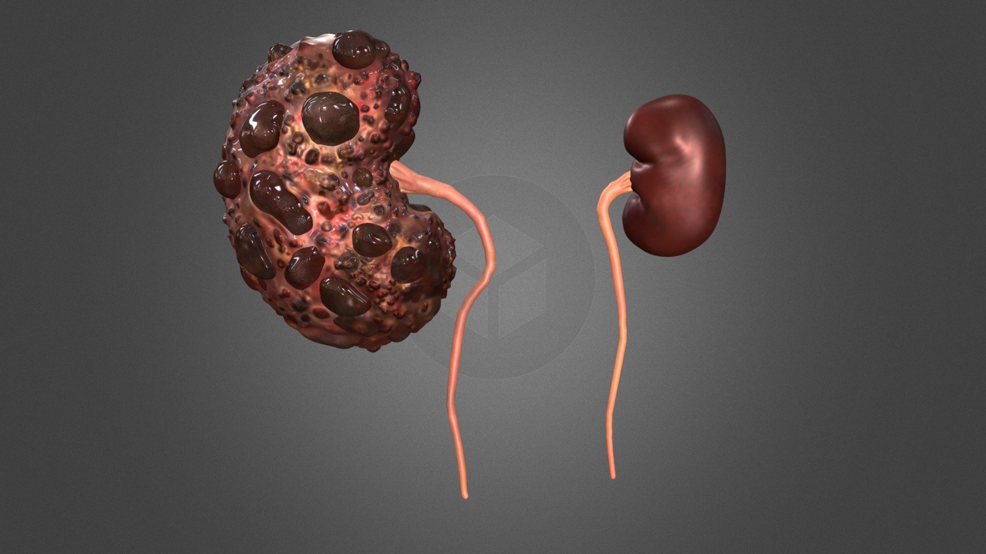 Polycystic Kidney Disease (PKD) - 3D model by EUNJUNG PARK (@qkrej96 ...