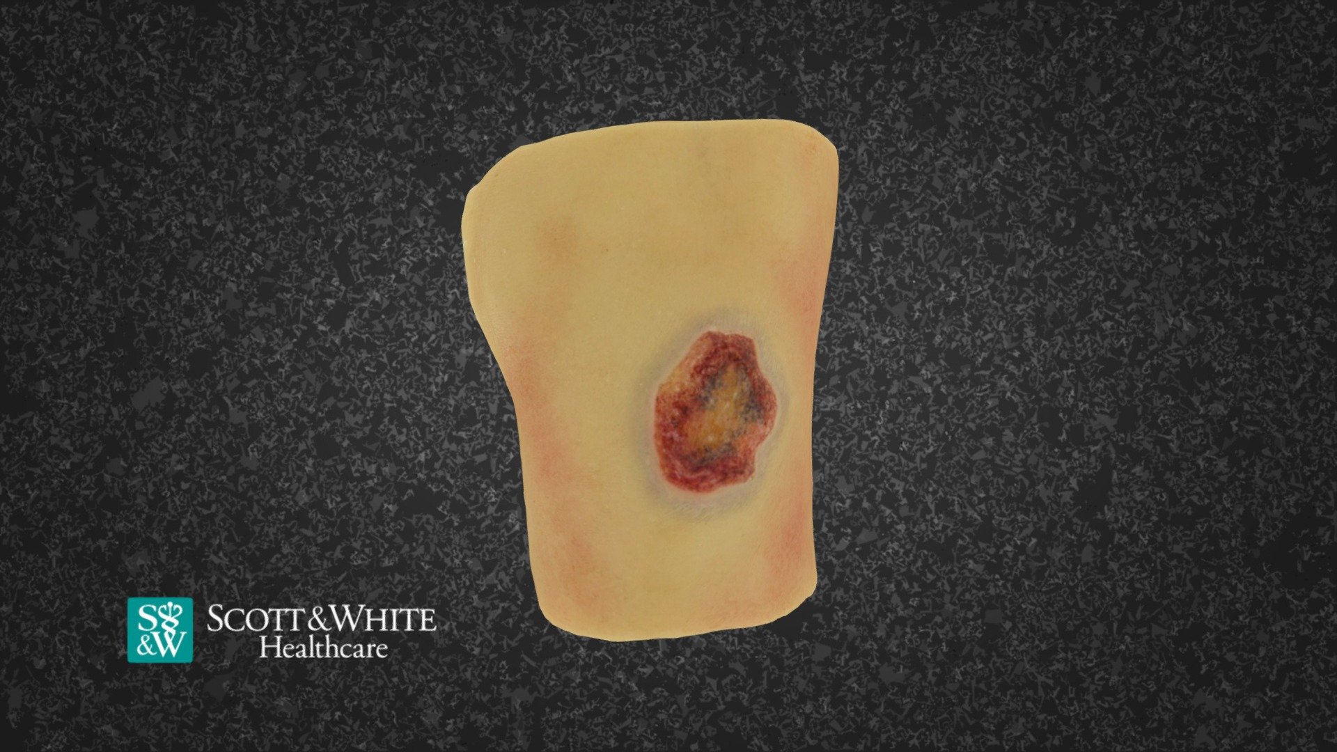 Ulcer On Skin -63517 - 3D model by Scott & White Moulage Project ...