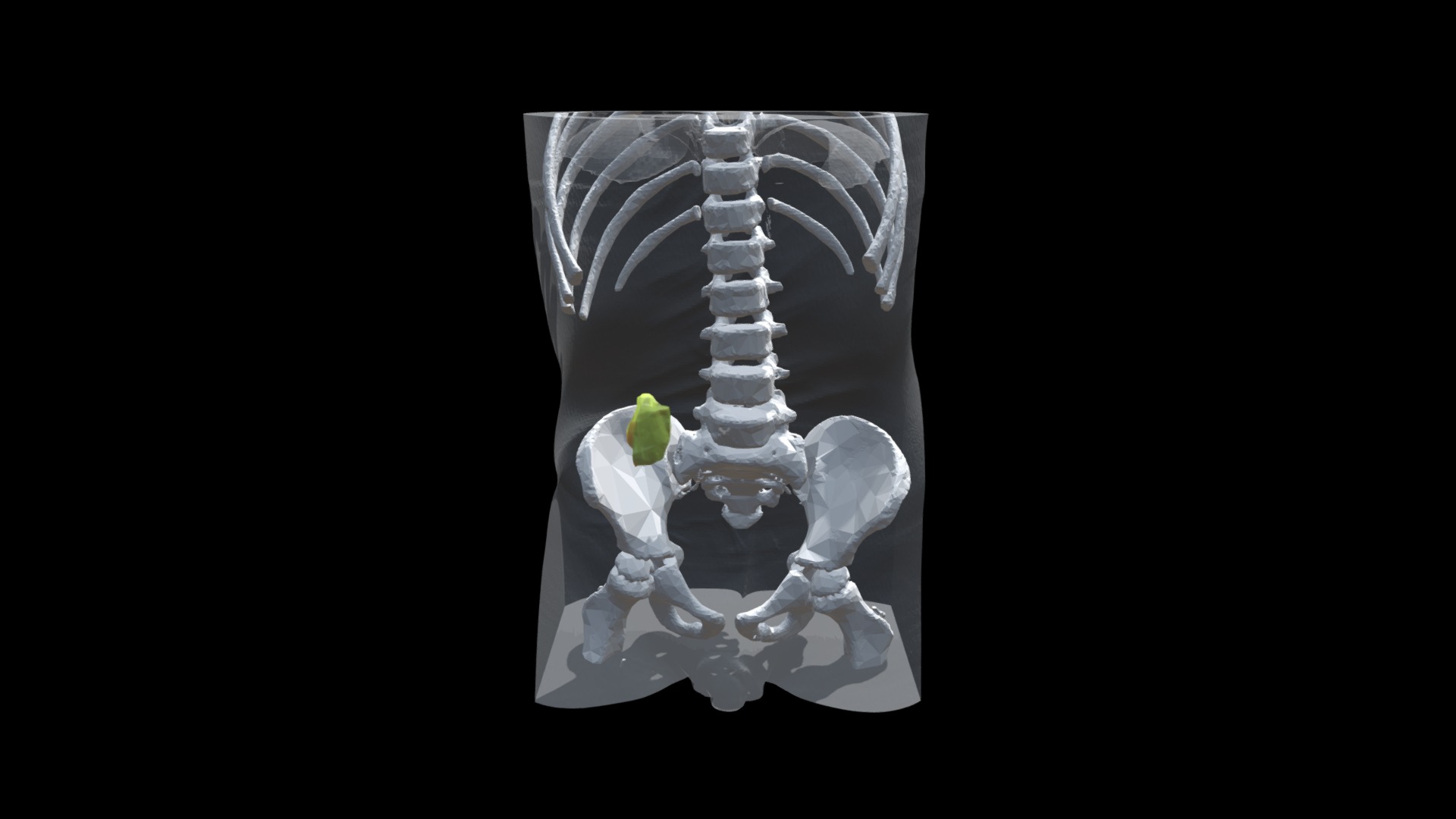 Abscess - 3D model by Lincoln Wong (@lincolnwong) [dc36cad] - Sketchfab