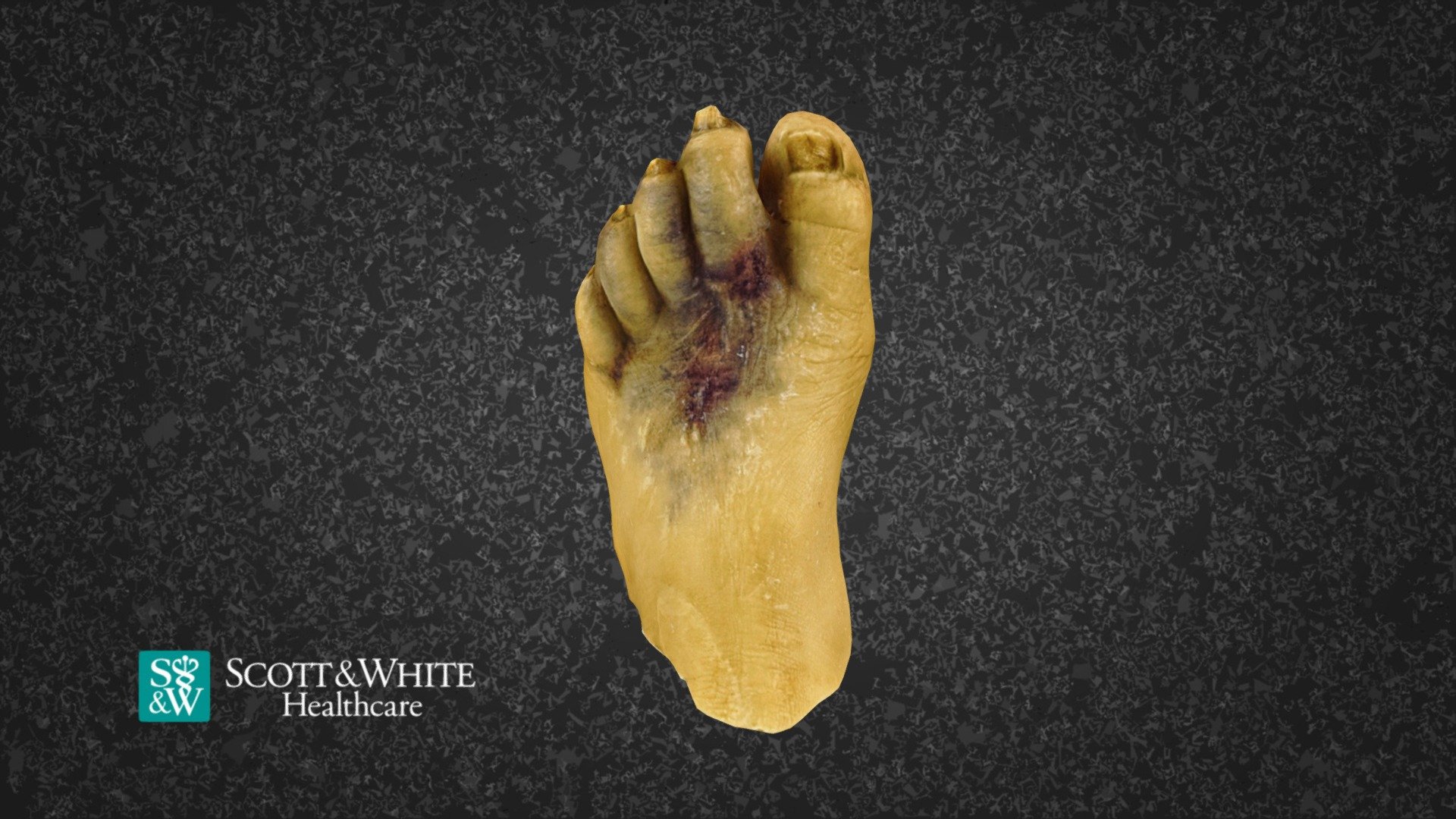 Left Foot with Diabetic Ulcers and Necrosis - 3D model by Scott & White ...