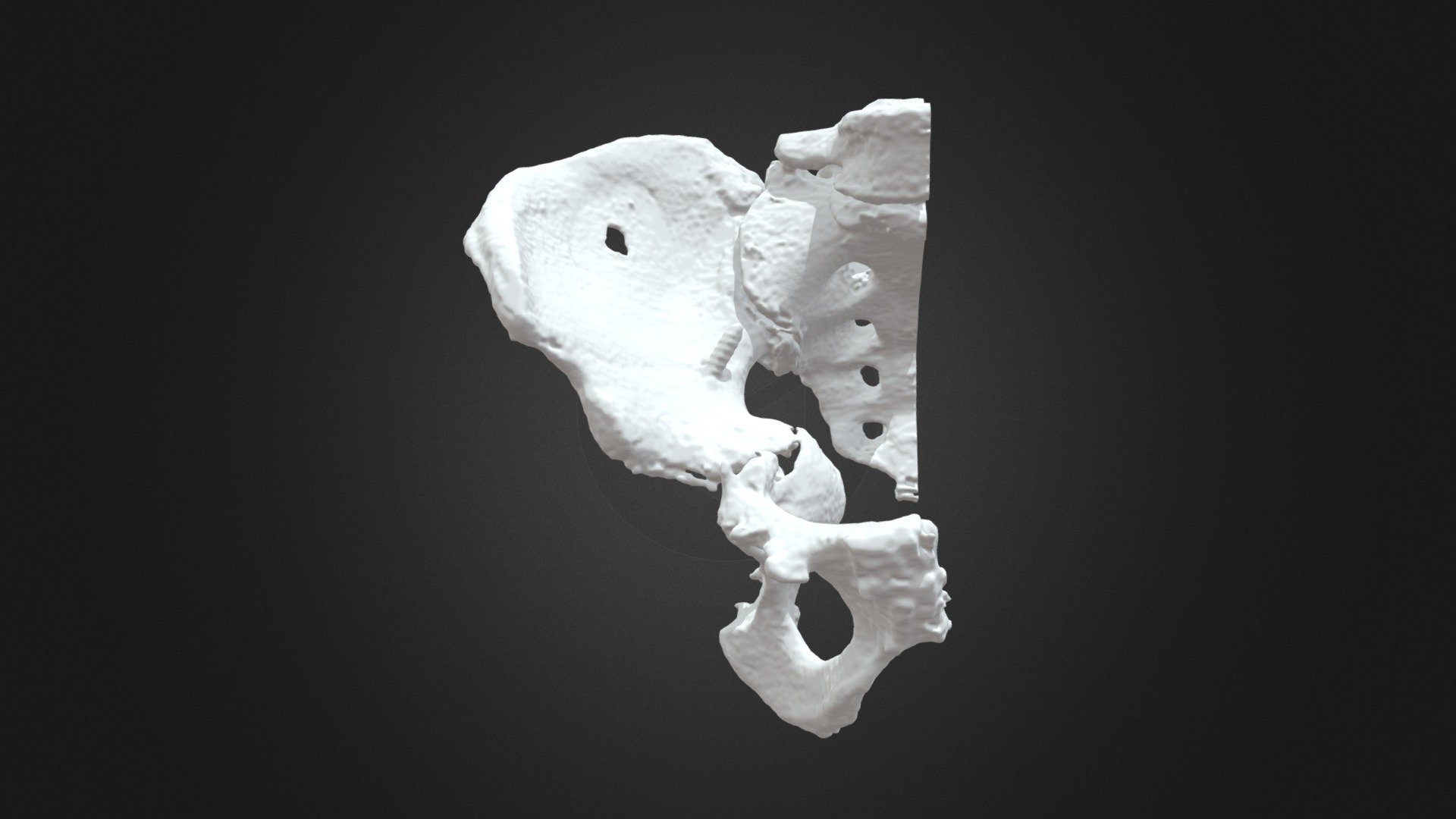 Right Hemipelvis without Bone Graft - 3D model by yuhuihuang [dc71c84 ...