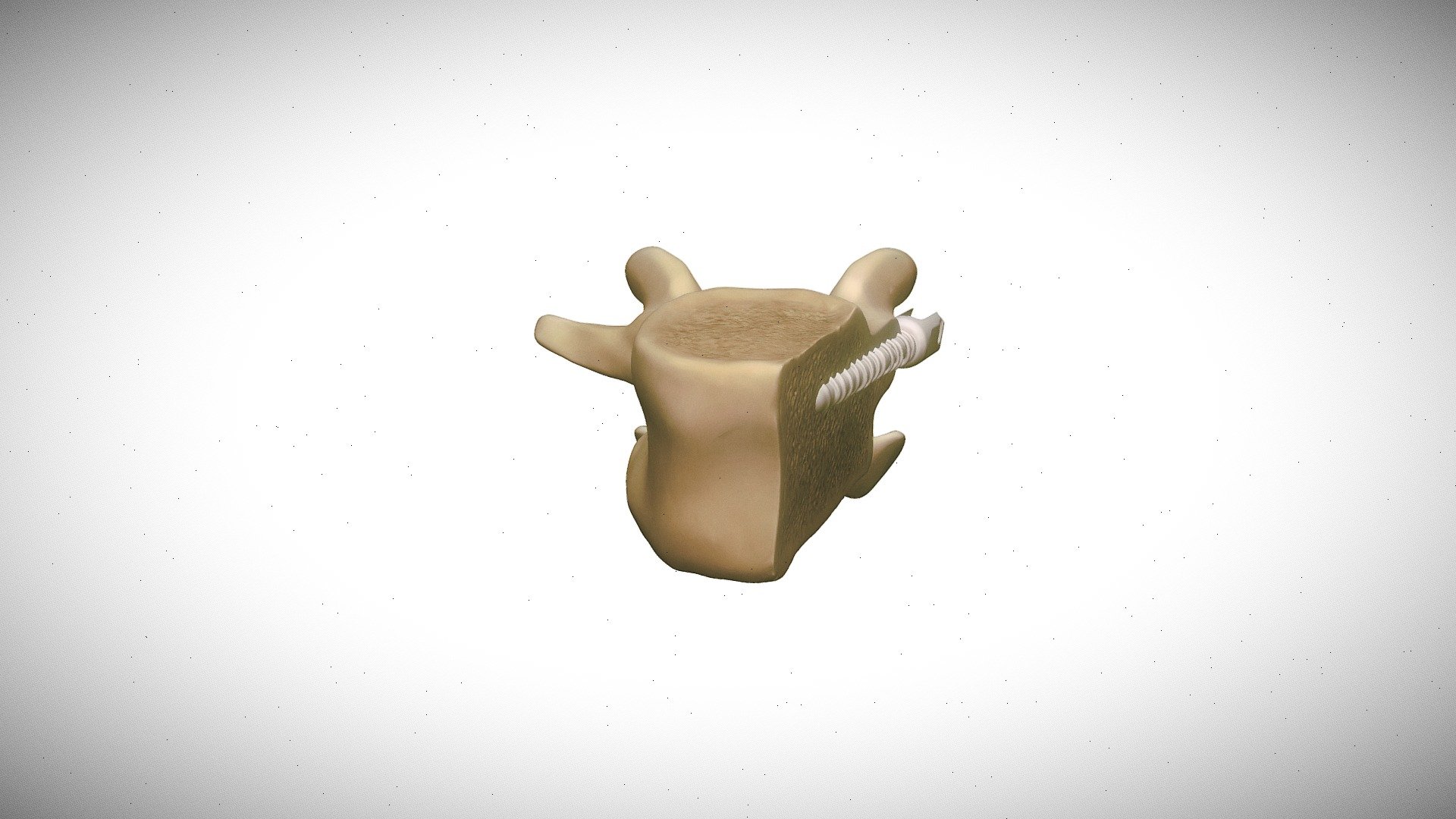 compressed_pedicle_screw_and_vertebrae_ - 3D model by blendedlearning ...