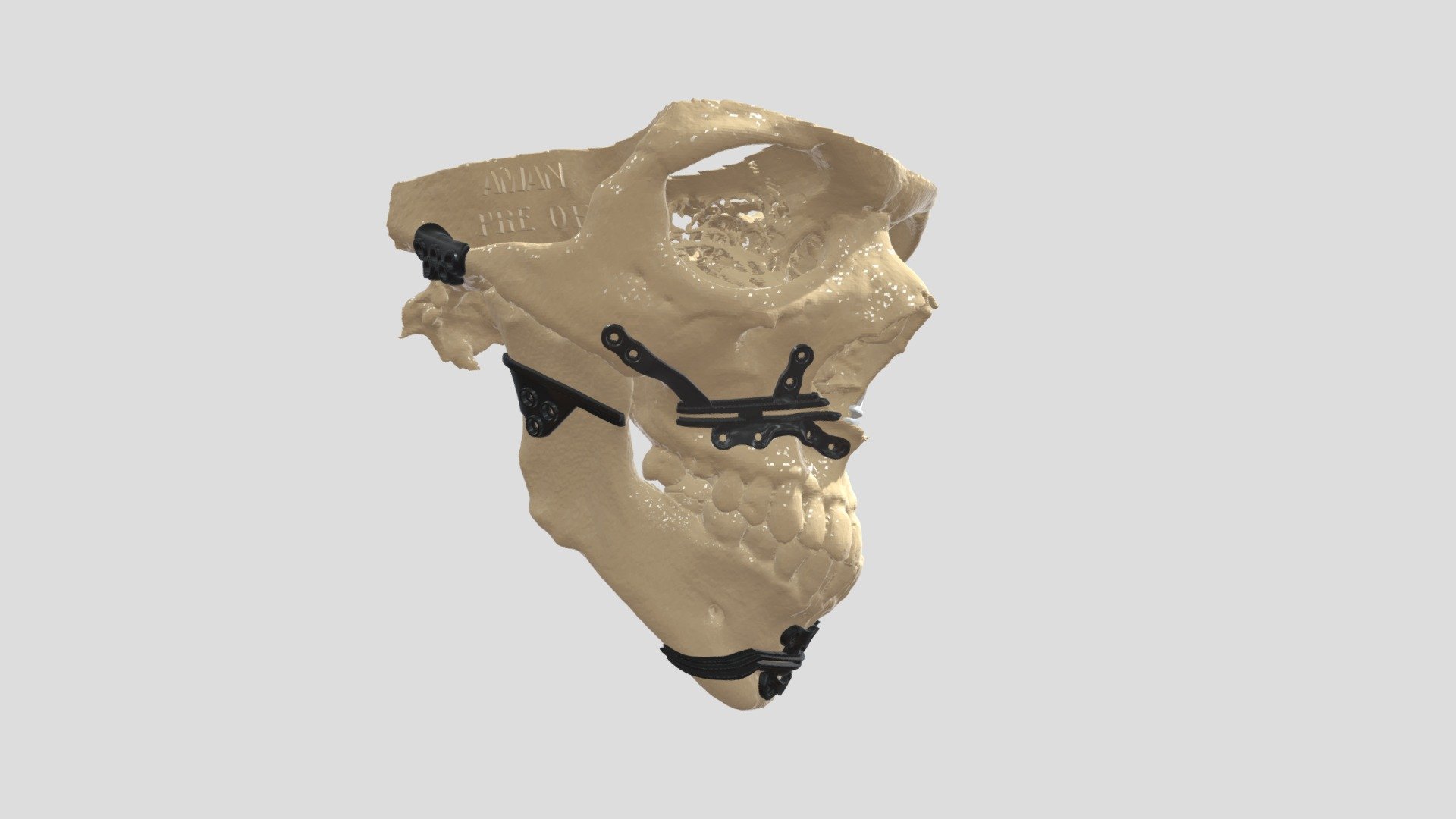 TMJ WITH ORTHOGNATHIC - 3D model by LUCID Implants (@LUCID_Implants) [dc863a3] - Sketchfab
