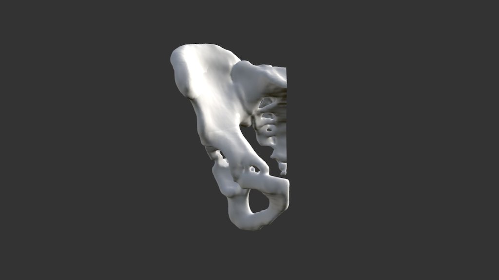 Pelvis Fracture - T-Shaped - 3D model by jgrayburn [dca8438] - Sketchfab