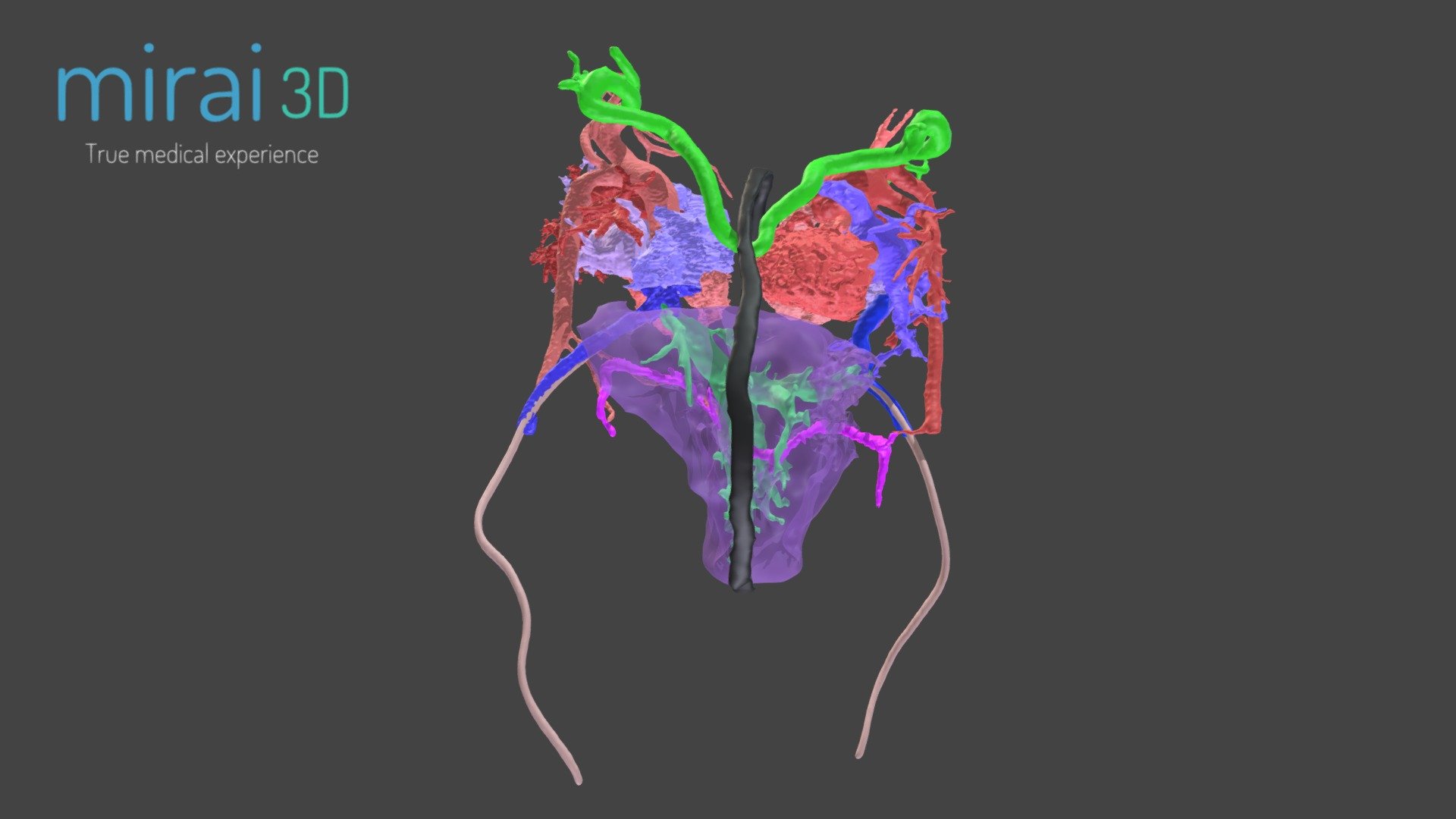 Thoracopagus conjoined twins - 3D model by MIRAI3D [dd27028] - Sketchfab
