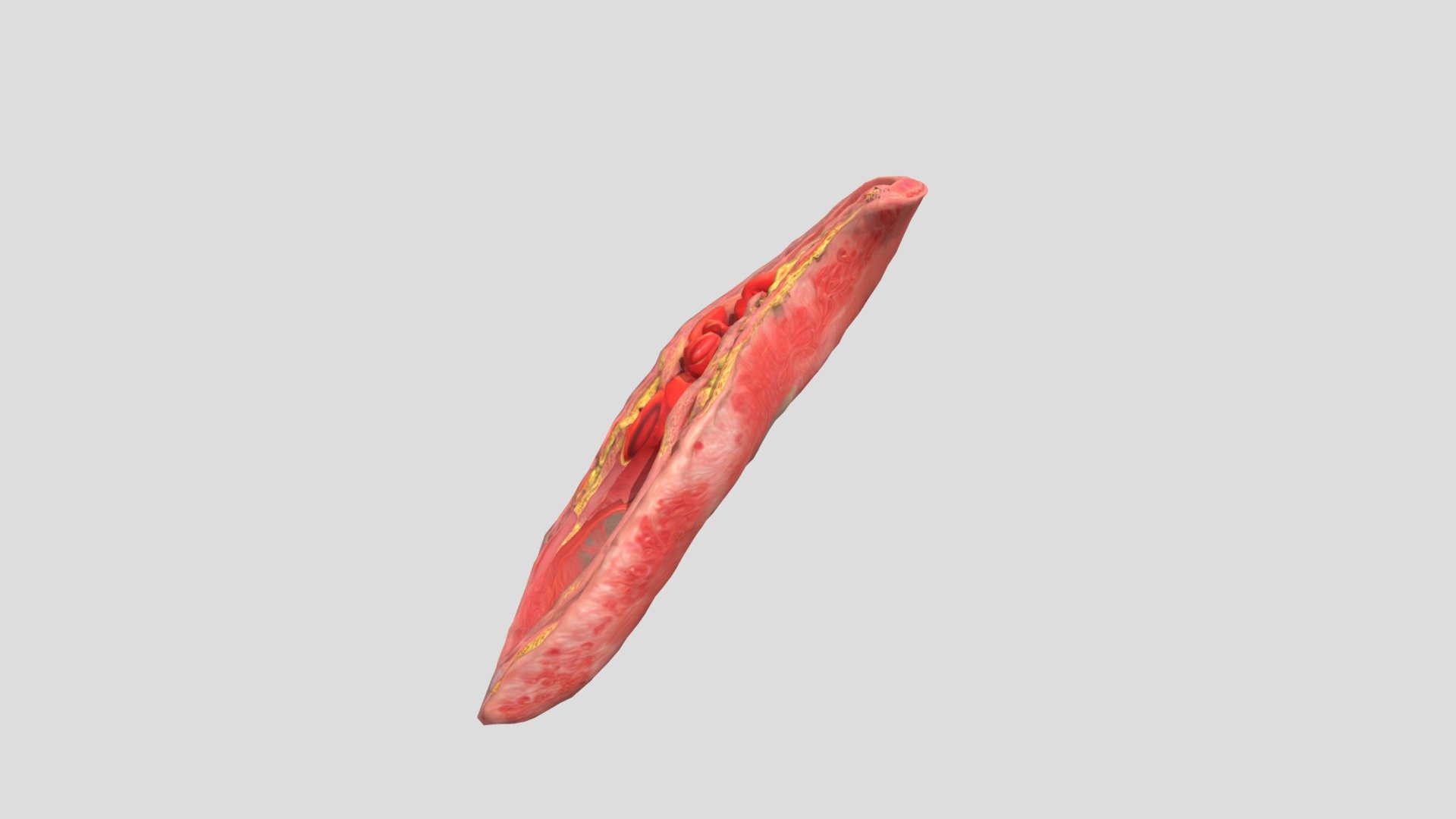 Atherosclerosis Illustration - 3D model by s.borrata.diego [dd32c9c ...