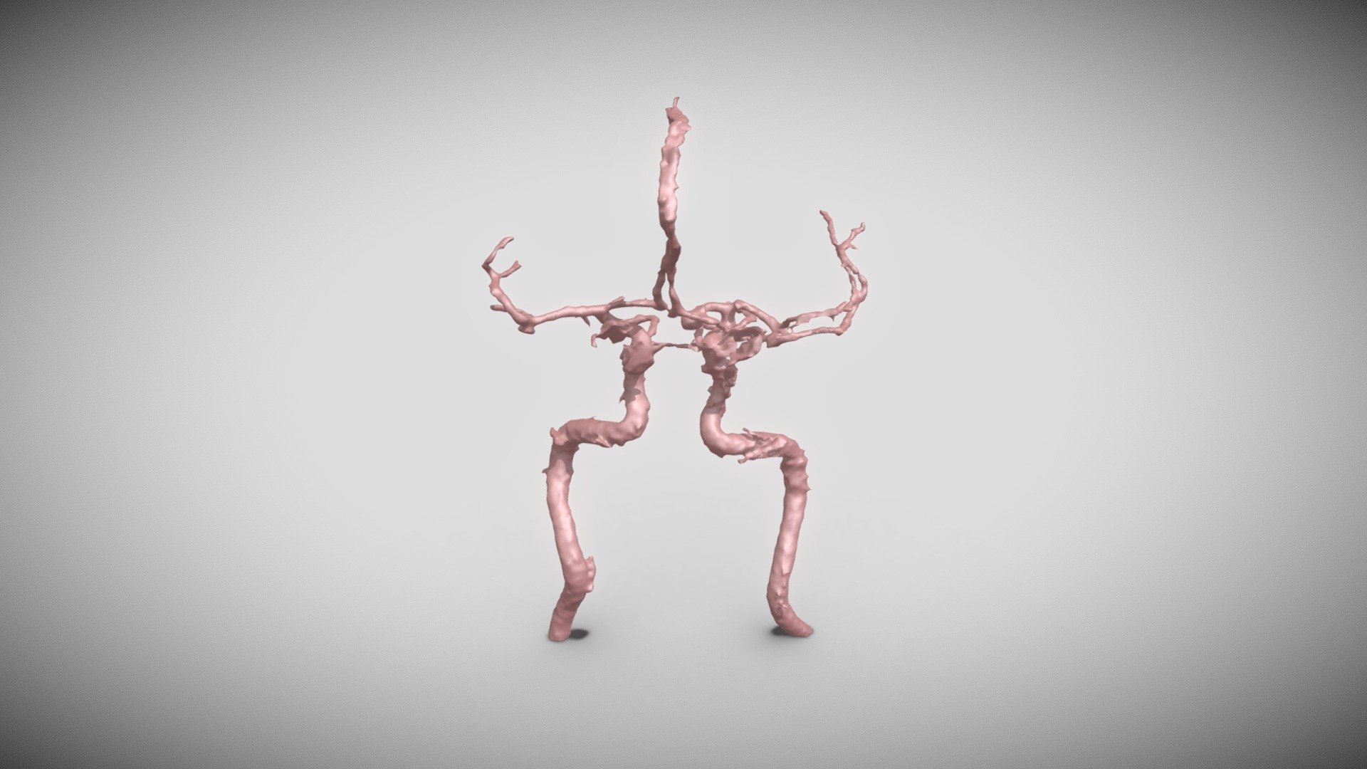 A1 Fenestration Aneurysm - 3D model by Dr. Samuel Damin (@sdamin ...