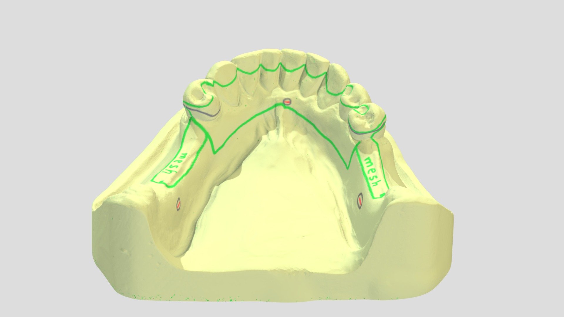 Class I Kennedy RPD Cast with Drawn Design - 3D model by ramiammoun ...
