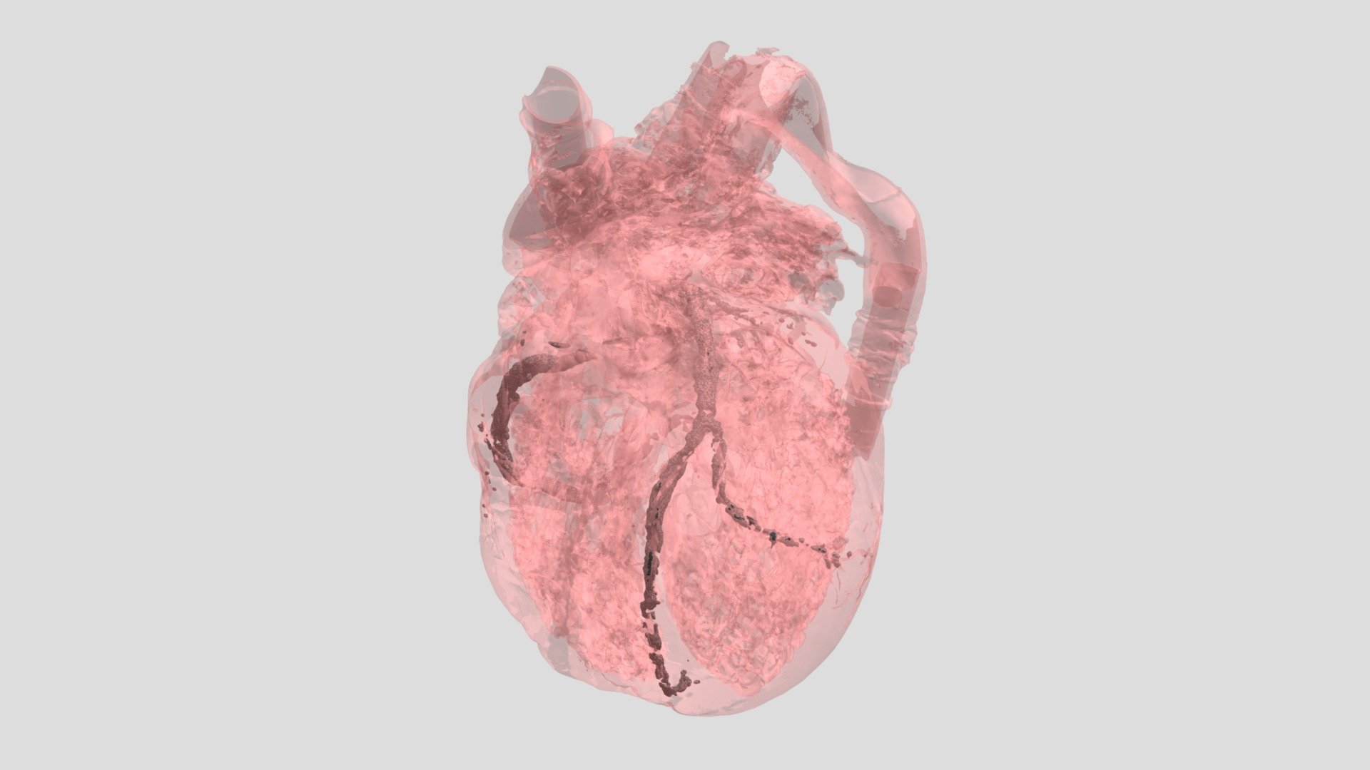 CAD Calcification: HH0567 - Download Free 3D model by VisibleHeartLabs ...