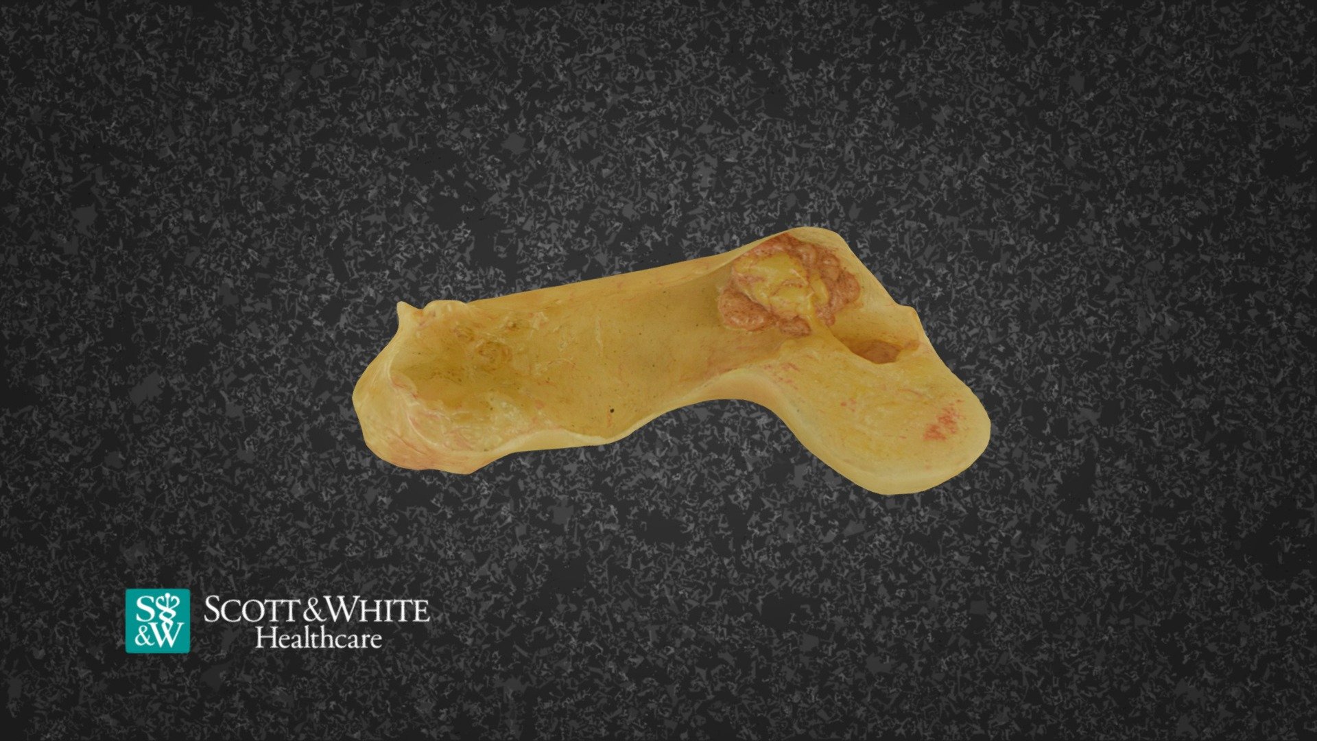 Fallopian Tube Adenocarcinoma 59023 - 3D model by Scott & White Moulage ...