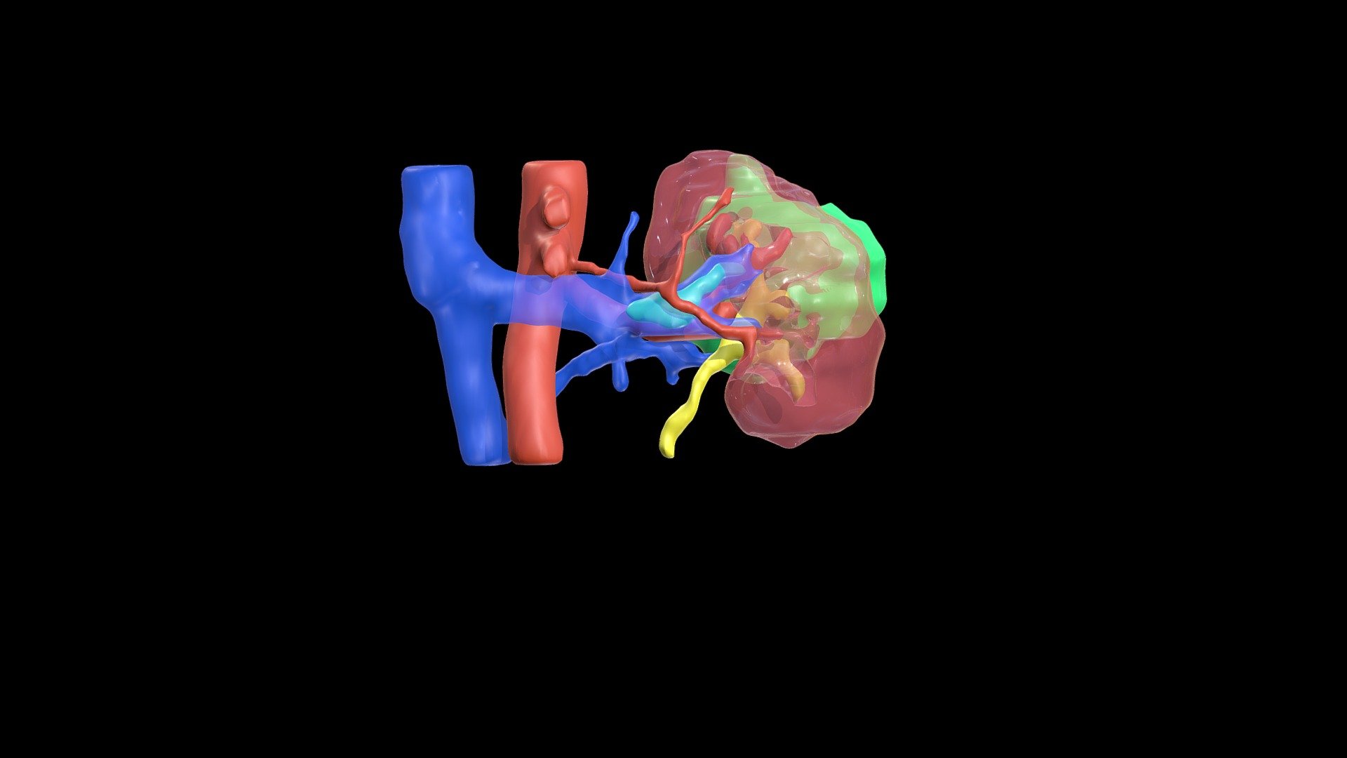 Left Renal Tumor - 3D model by Cirurgic3D (@neorenal) [de9bf36] - Sketchfab