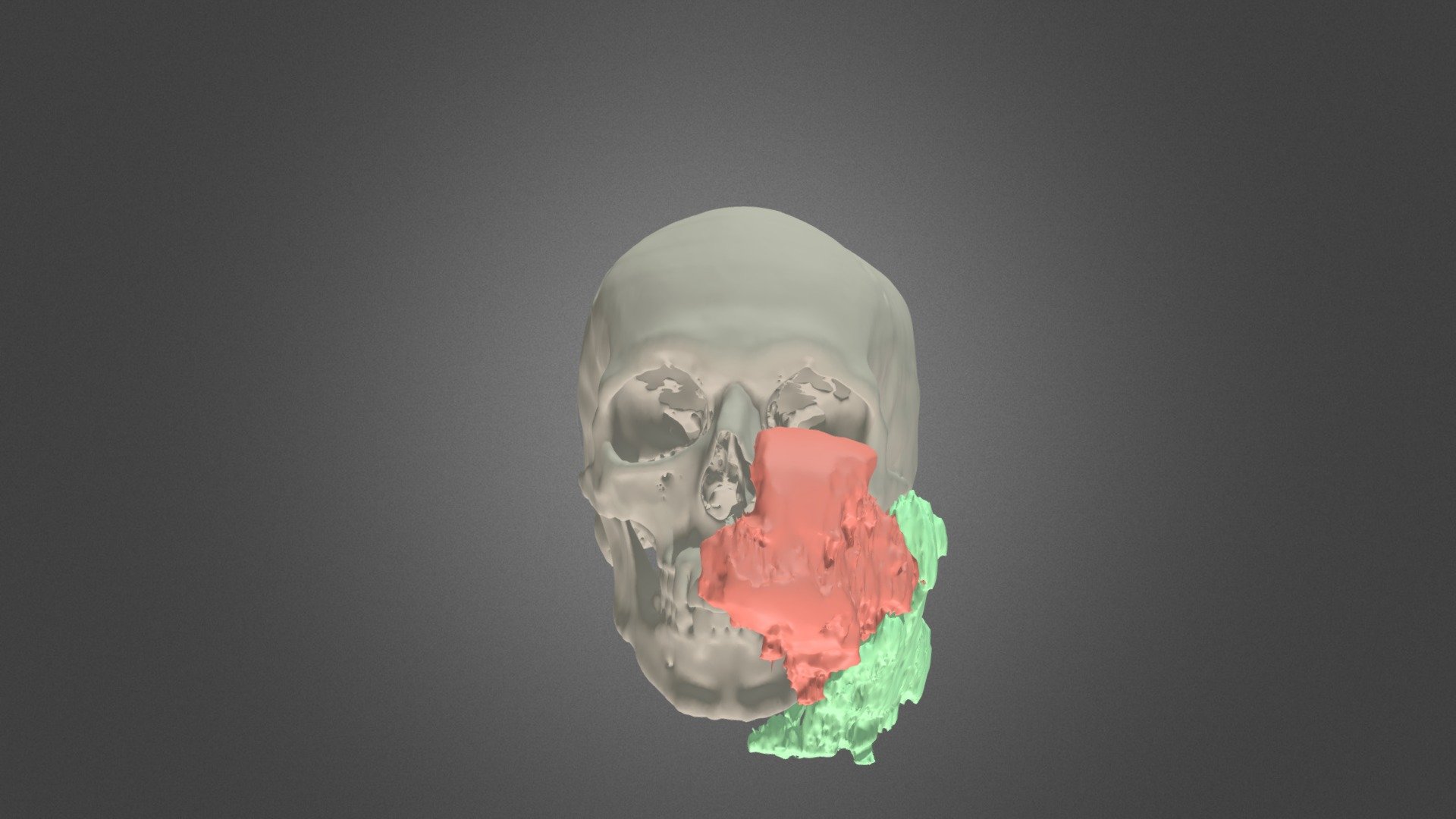 3D visualization of a soft tissue abscess - 3D model by n.ignatov ...