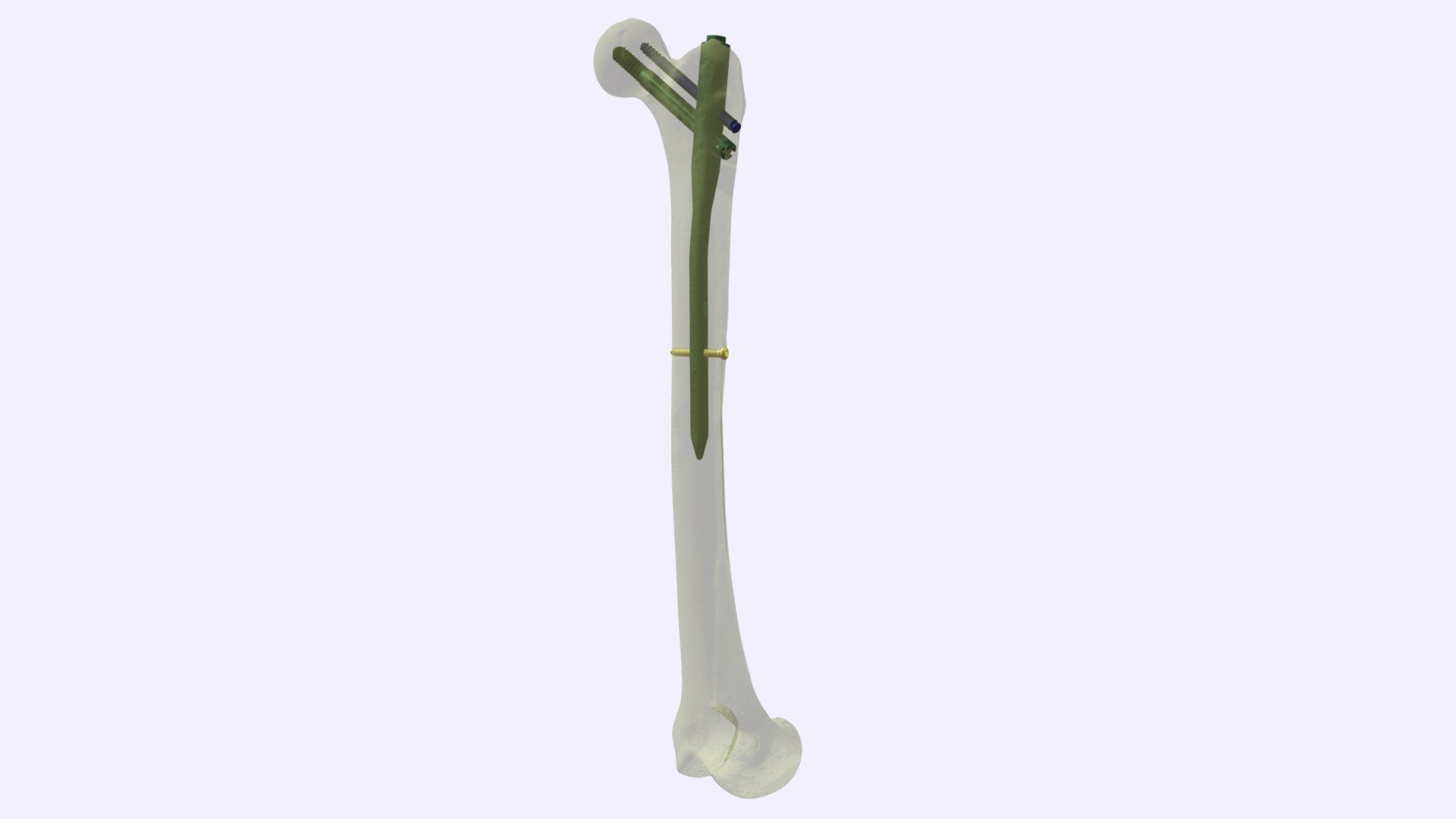 Proximal Femoral γ-Nail (γ-PFN)-Short version - 3D model by OSTEOMED-M ...