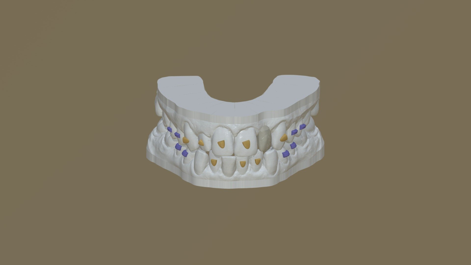 Both - 3D model by toothtechnology [df47097] - Sketchfab