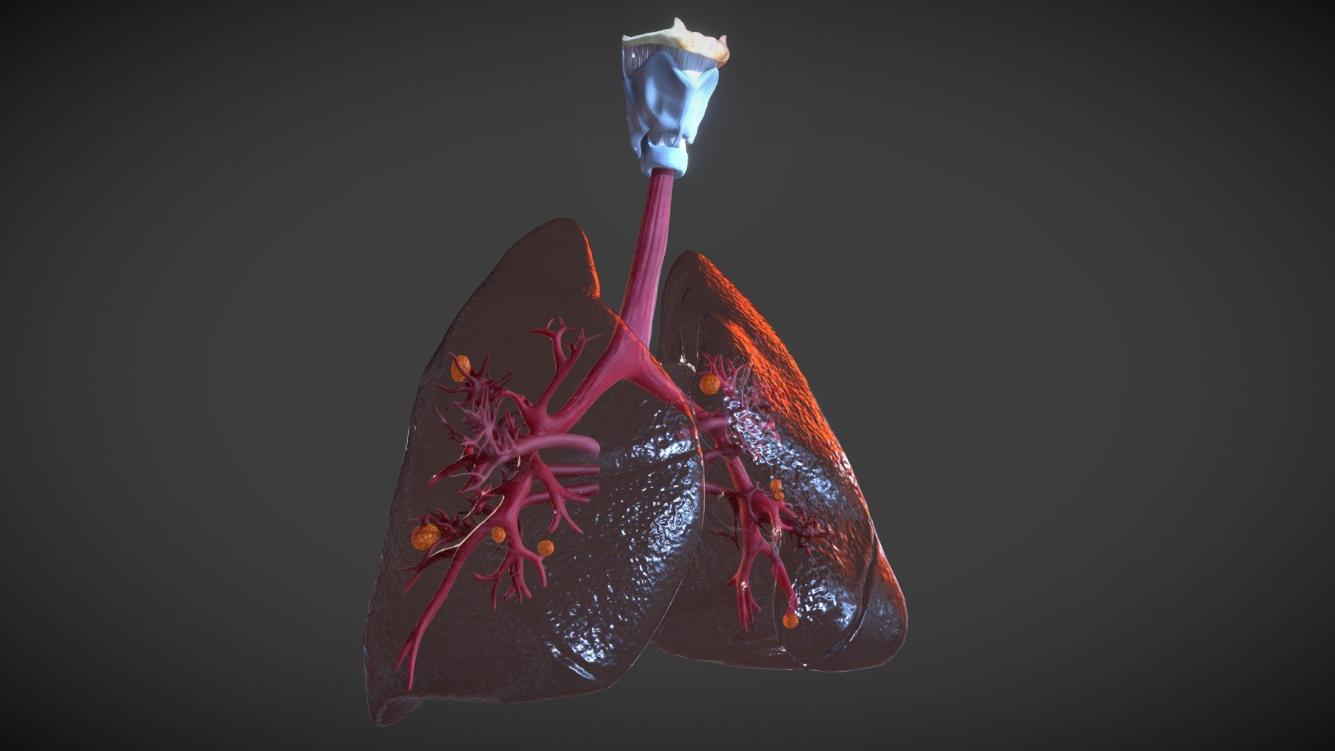 Lung cancer - Buy Royalty Free 3D model by Ebers [df80810] - Sketchfab ...
