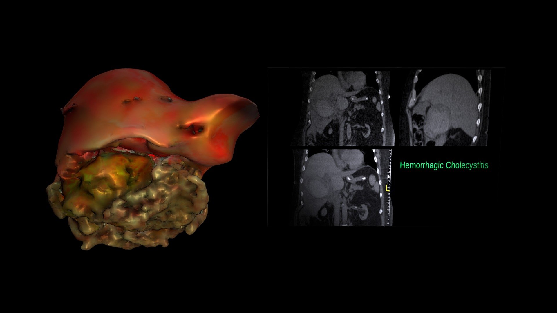 Hemorrhagic Cholecystitis - 3D model by tl0615 [df9f714] - Sketchfab