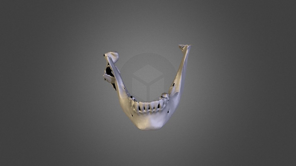 Complex Mandible Fracture - 3D model by VIDENTIS [e0c720c] - Sketchfab