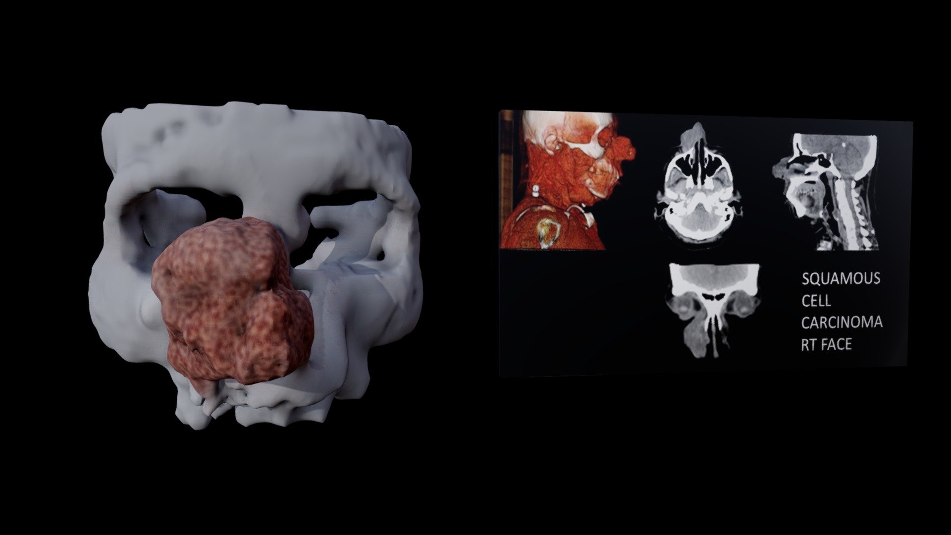 Squamous Cell Carcinoma of the Face - 3D model by tl0615 [e1c4e87 ...