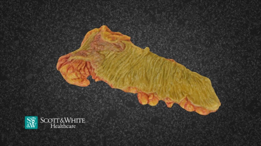 Sigmoid Adenocarcinoma 58299 - 3D model by Scott & White Moulage ...